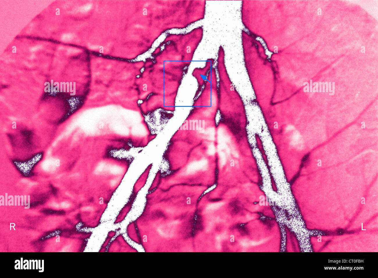 Iliac Stenosis Stockfotos und -bilder Kaufen - Alamy