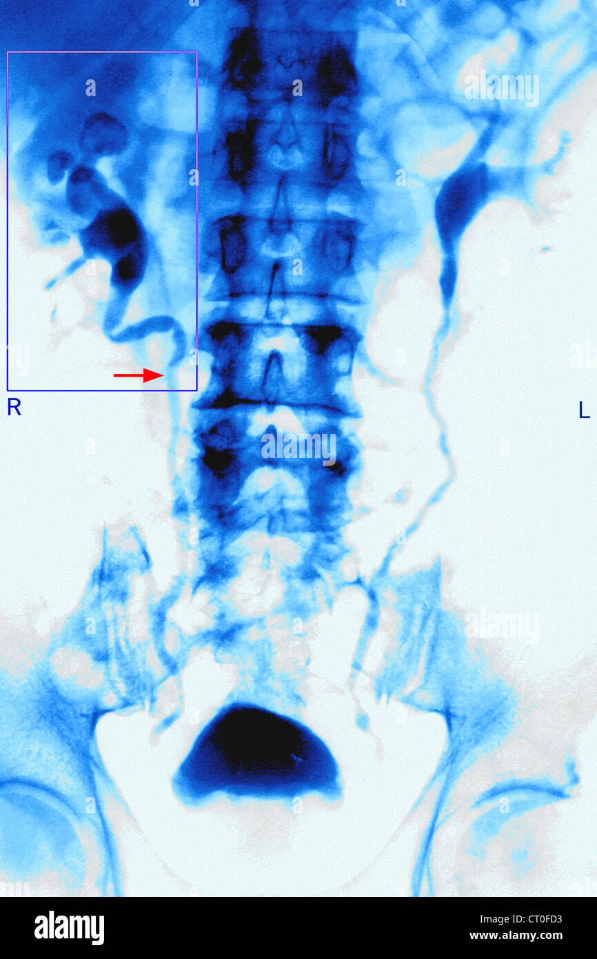 Ureteral lithiasis -Fotos und -Bildmaterial in hoher Auflösung – Alamy