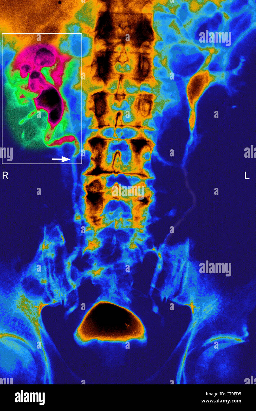 Ureteral lithiasis -Fotos und -Bildmaterial in hoher Auflösung – Alamy