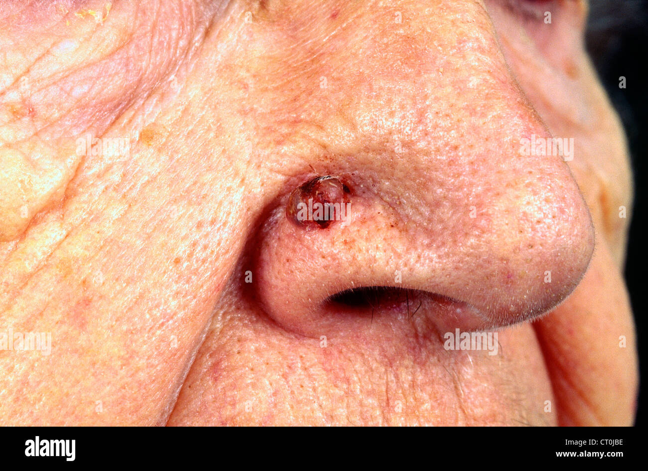 Anaplastisches karzinom -Fotos und -Bildmaterial in hoher Auflösung ...