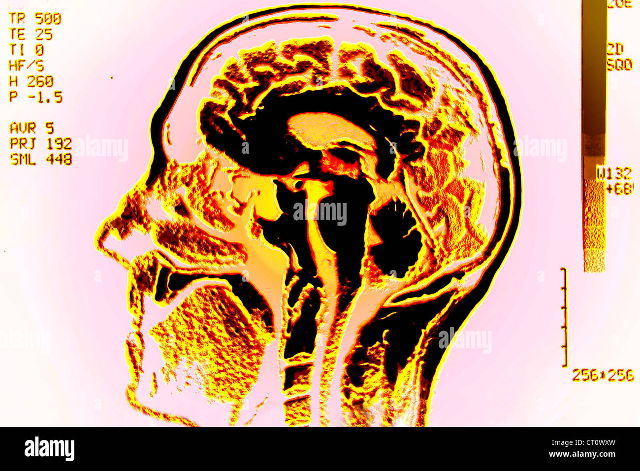 Mri scan des normalen gehirns -Fotos und -Bildmaterial in hoher Auflösung – Alamy