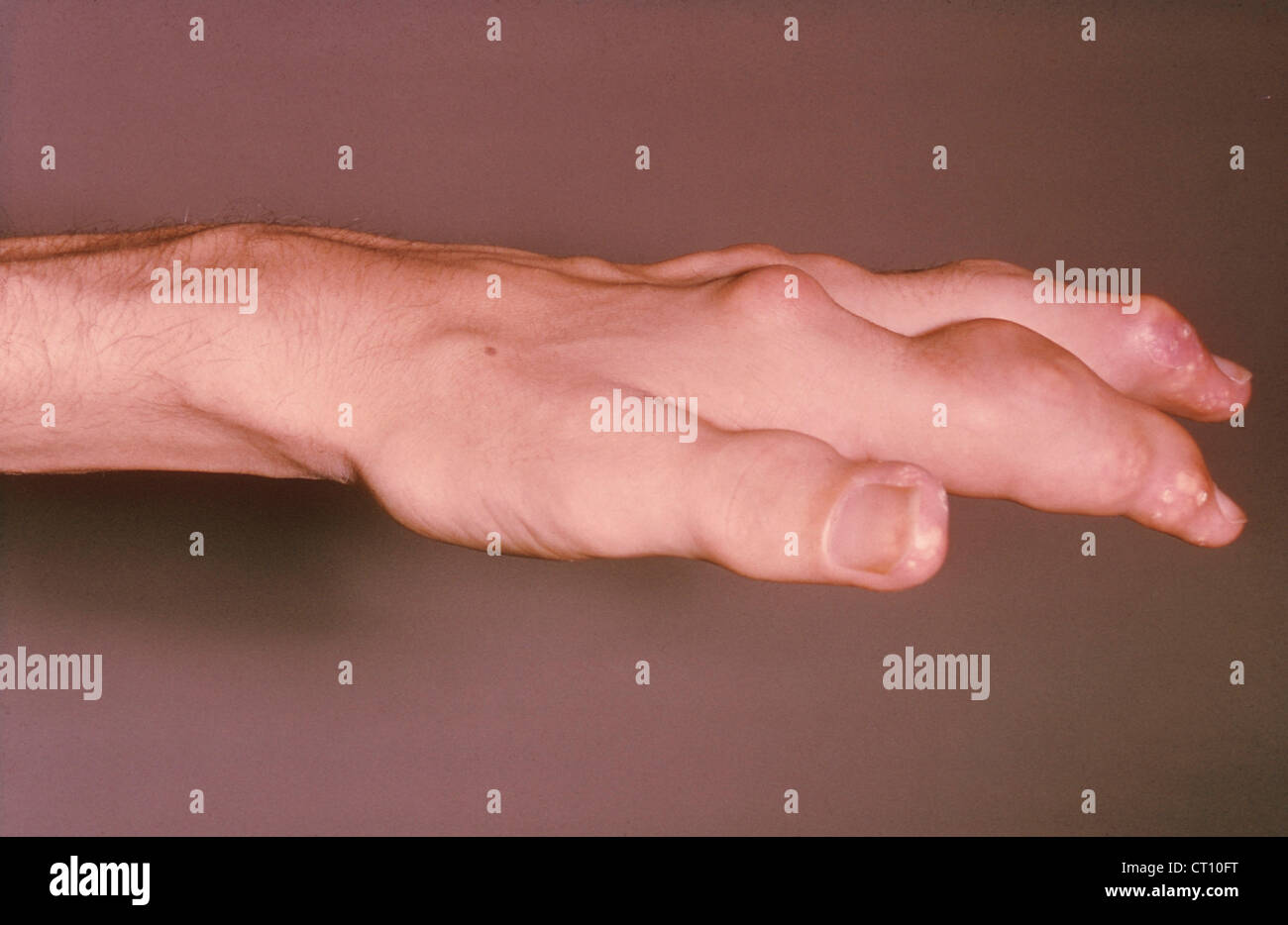 Der gicht -Fotos und -Bildmaterial in hoher Auflösung – Alamy