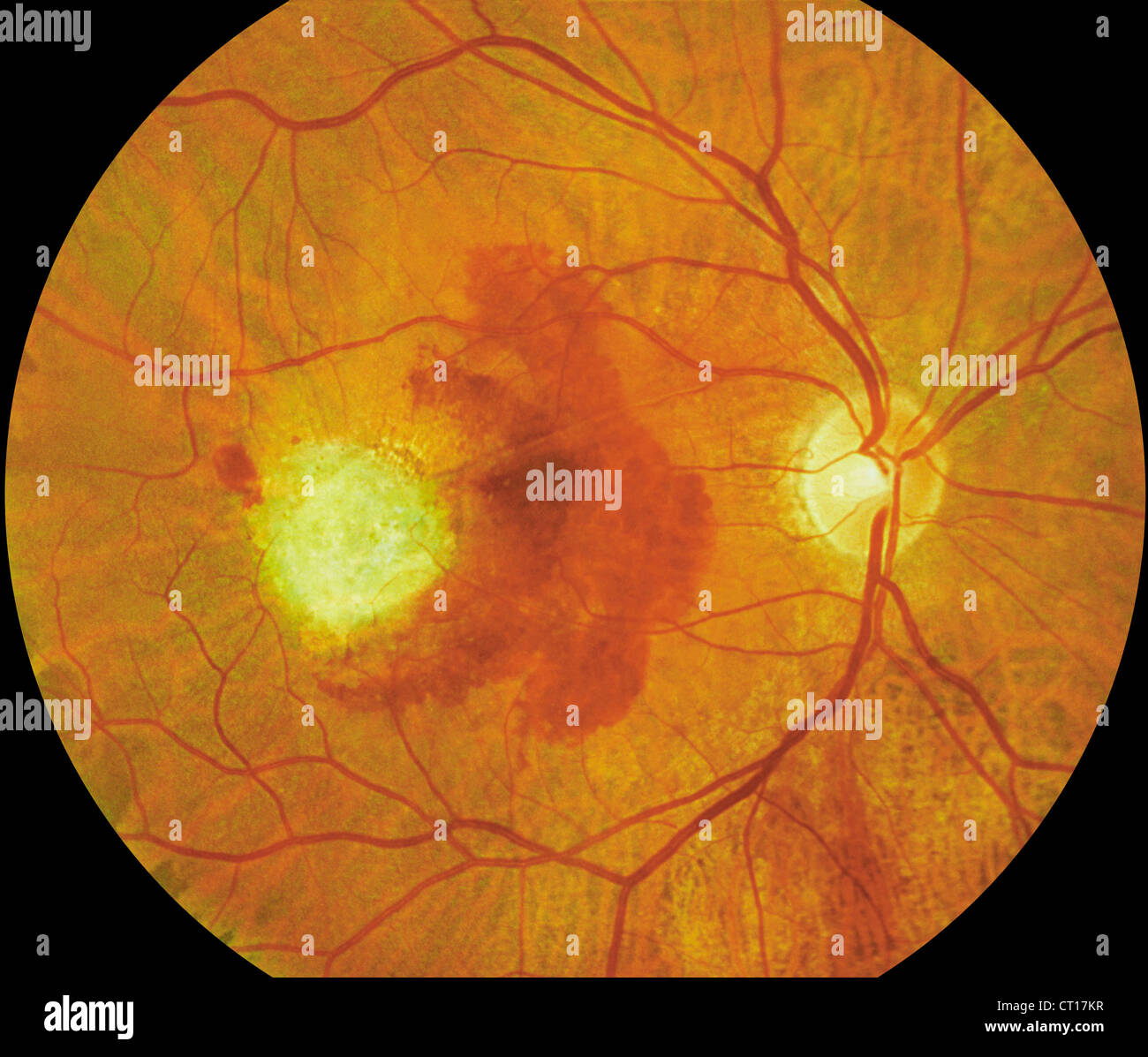Macular Degeneration Stockfotos & Macular Degeneration Bilder - Alamy