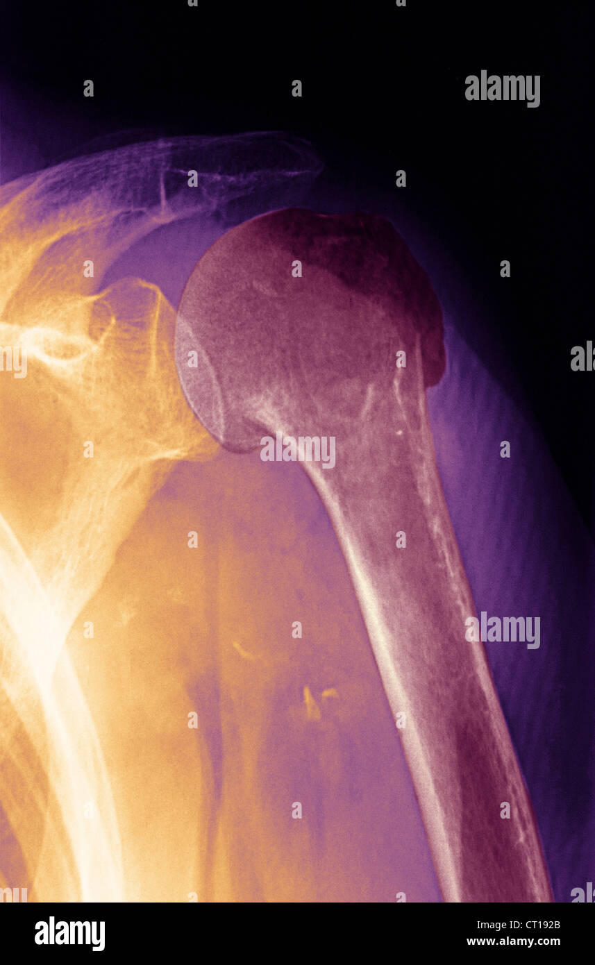 Hals des humerus -Fotos und -Bildmaterial in hoher Auflösung – Alamy