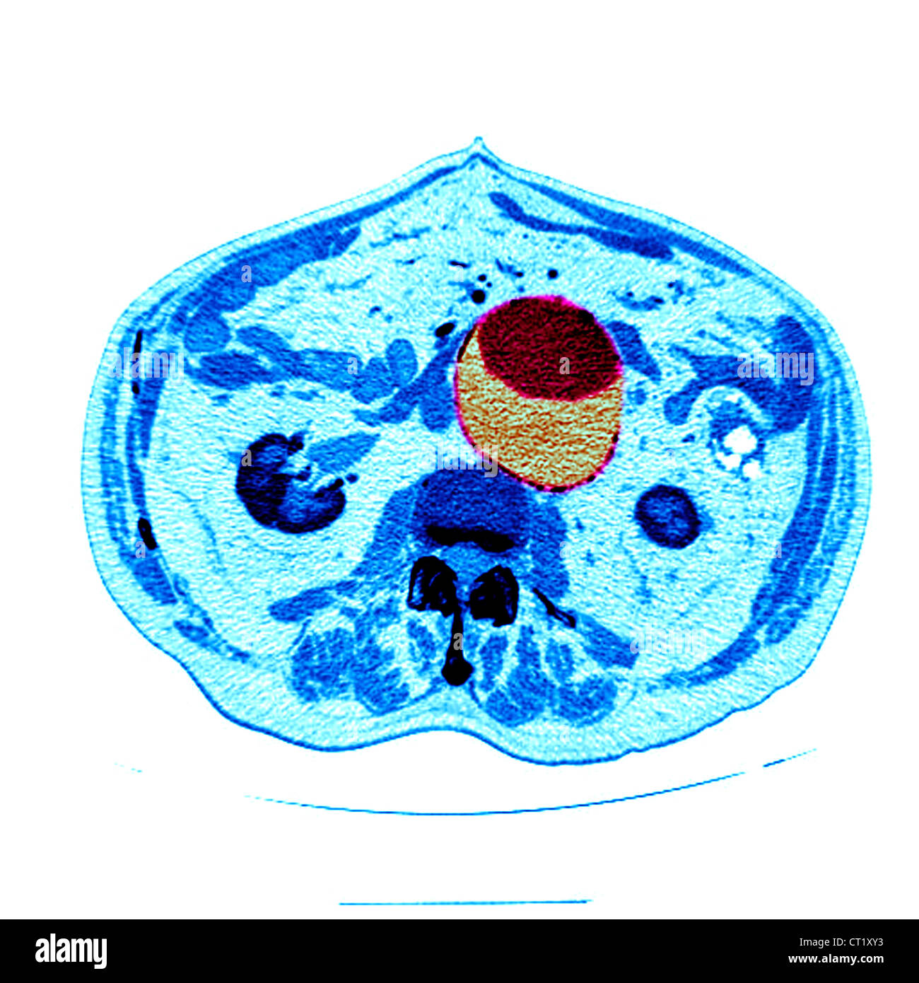Abdominal aorta aneurysm scan -Fotos und -Bildmaterial in hoher ...