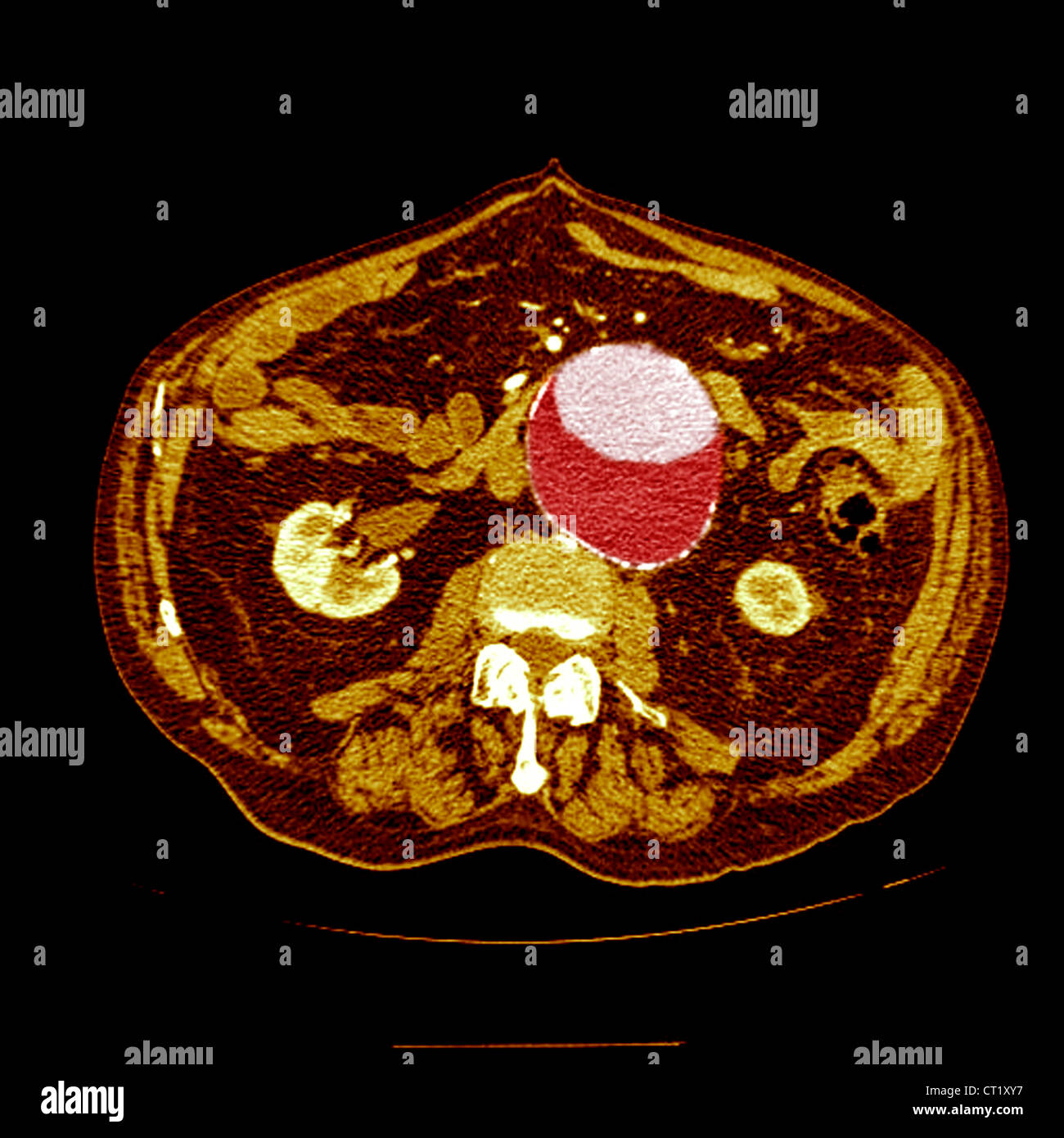 Abdominal aorta aneurysm scan -Fotos und -Bildmaterial in hoher ...