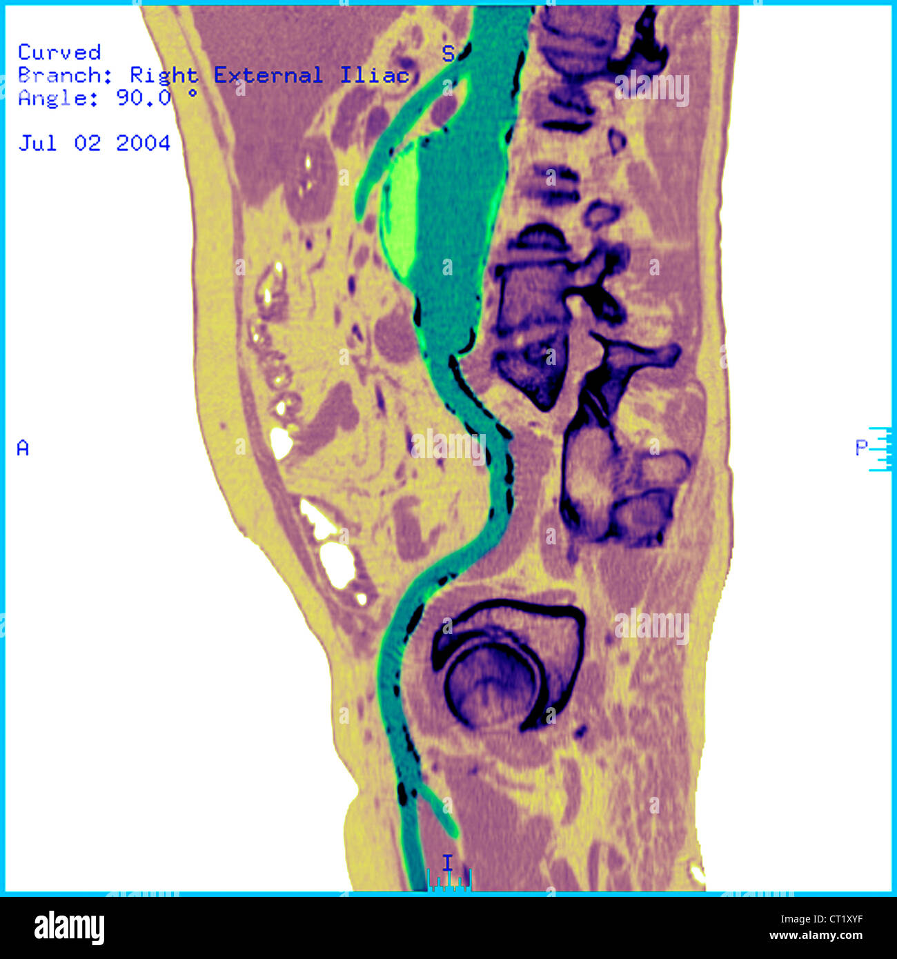 Abdominal aorta aneurysm scan -Fotos und -Bildmaterial in hoher ...