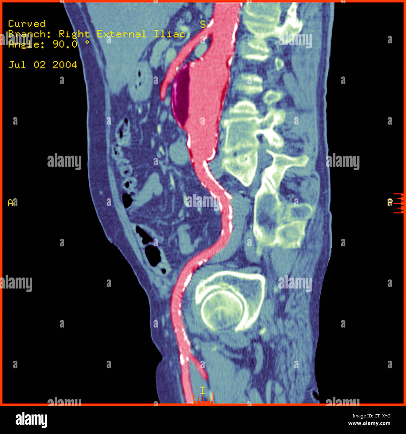 Abdominal aorta aneurysm scan -Fotos und -Bildmaterial in hoher ...