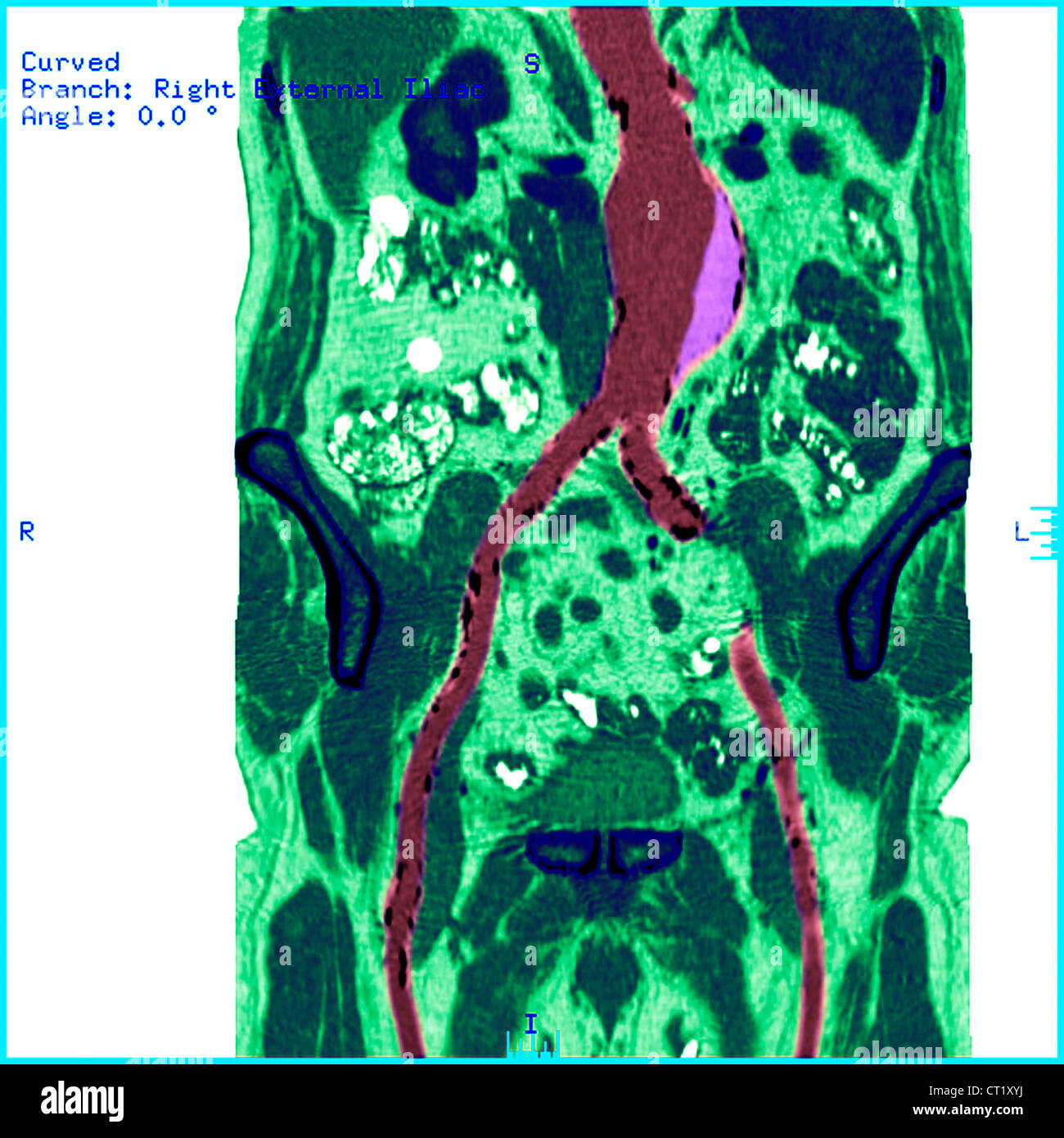 Abdominale aorta -Fotos und -Bildmaterial in hoher Auflösung – Alamy
