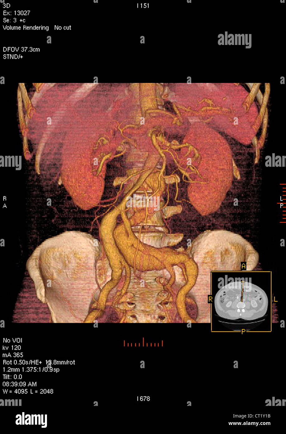 BECKENKAMM ANEURYSMA, SCAN Stockfotografie - Alamy