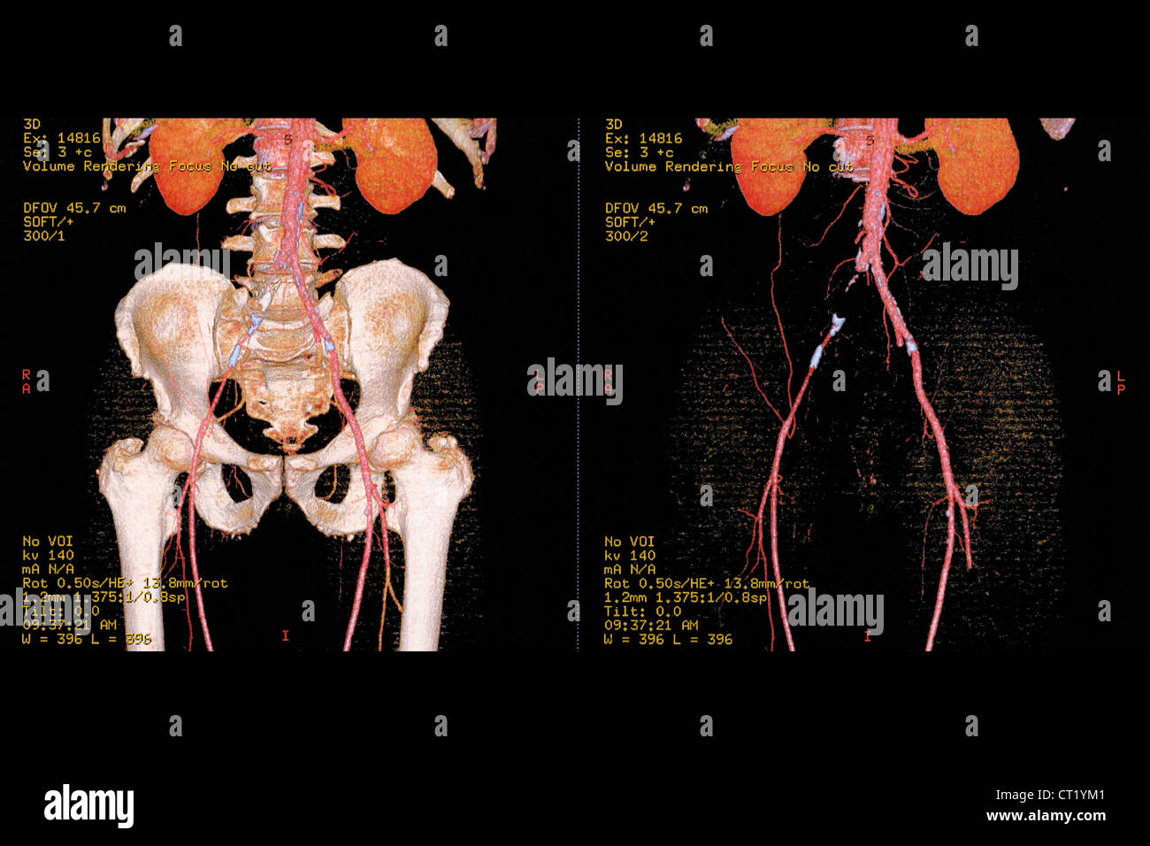 Internal iliac vein -Fotos und -Bildmaterial in hoher Auflösung – Alamy