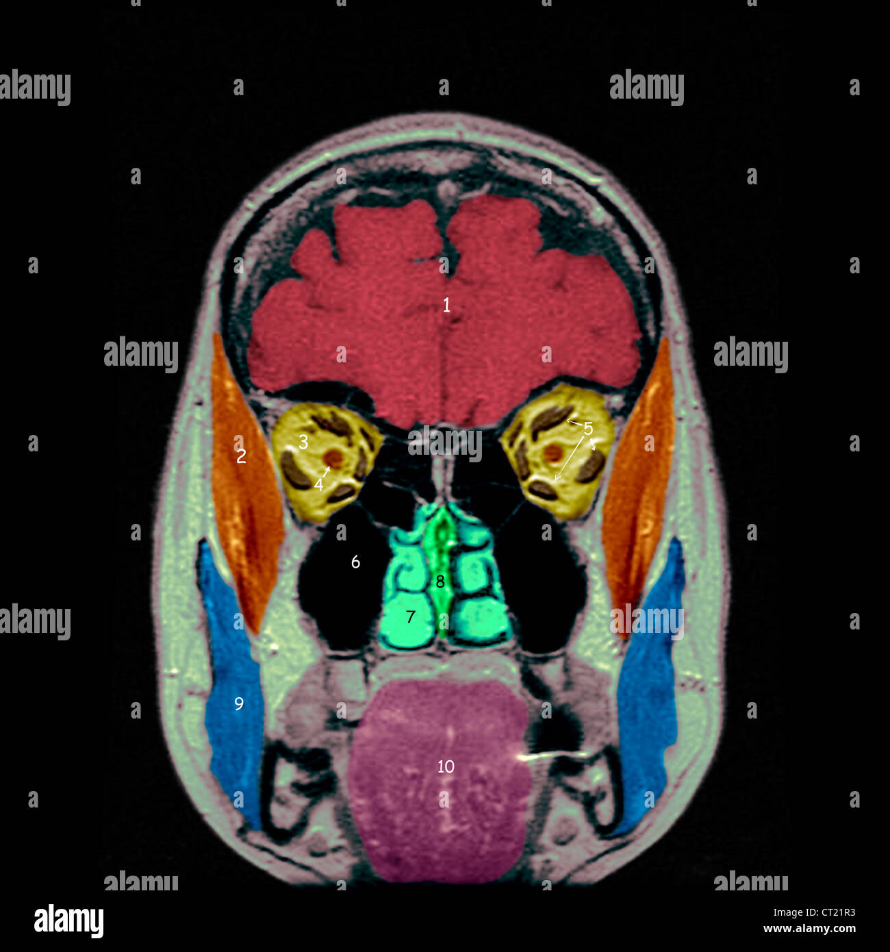Normal mri sinuses -Fotos und -Bildmaterial in hoher Auflösung – Alamy