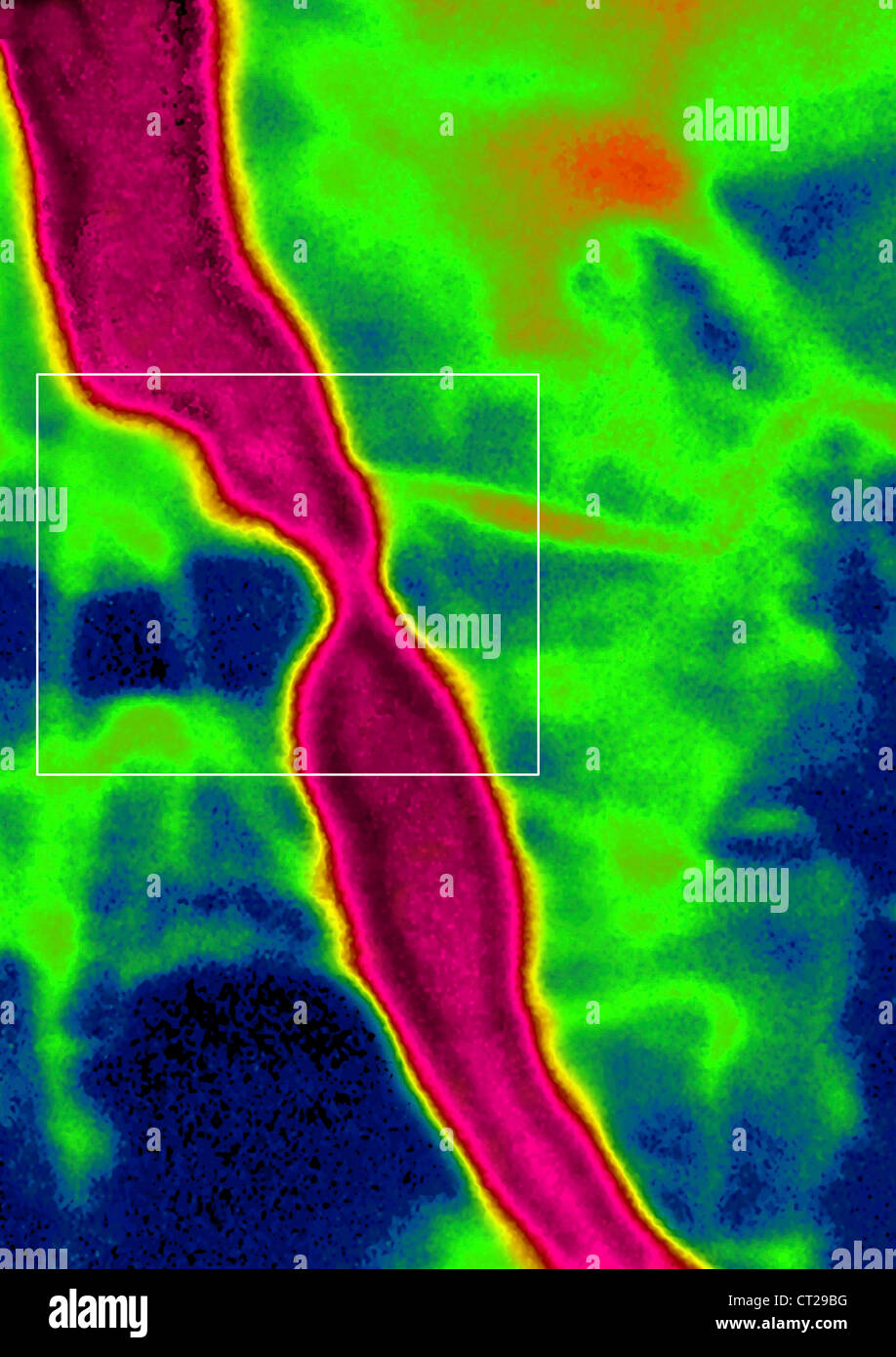 BECKENKAMM STENOSE, ANGIOGRAPHIE Stockfotografie - Alamy