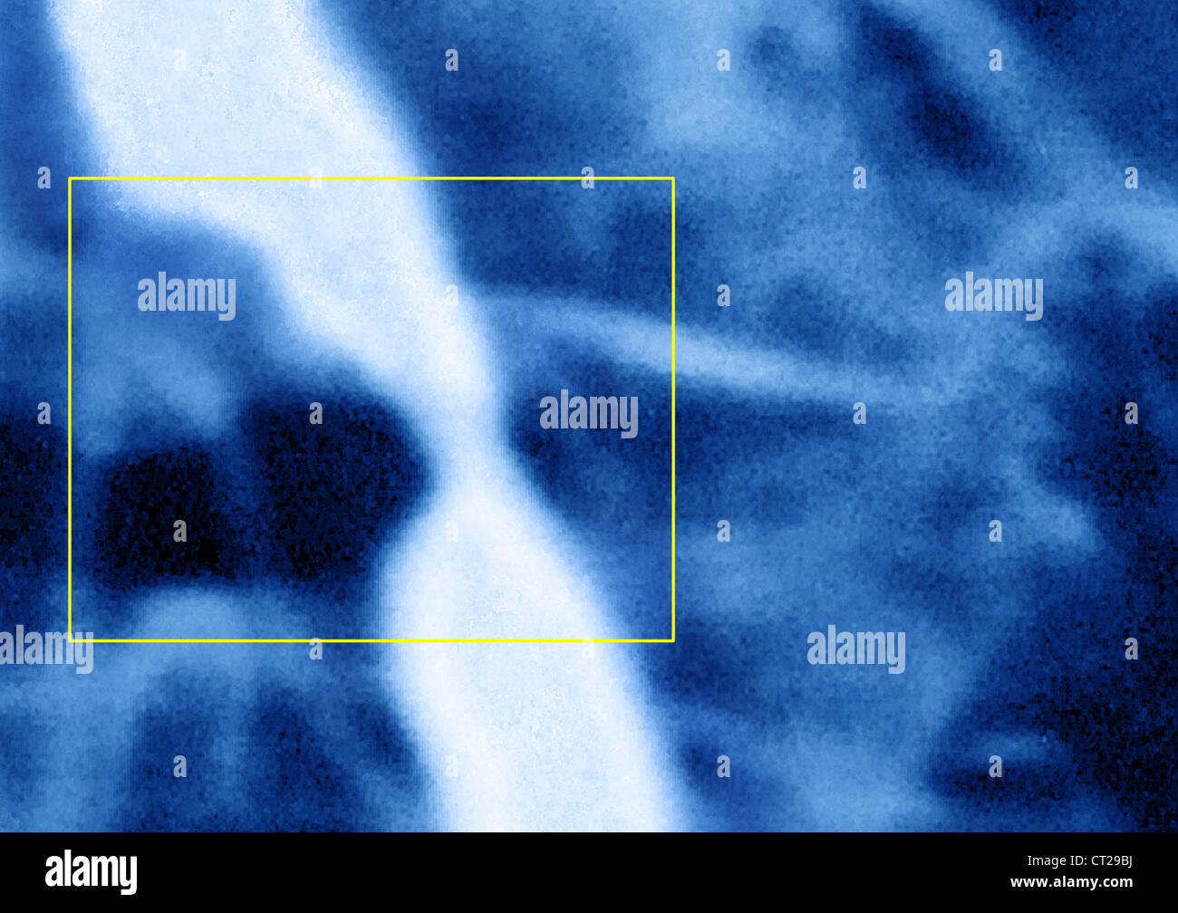 BECKENKAMM STENOSE, ANGIOGRAPHIE Stockfotografie - Alamy