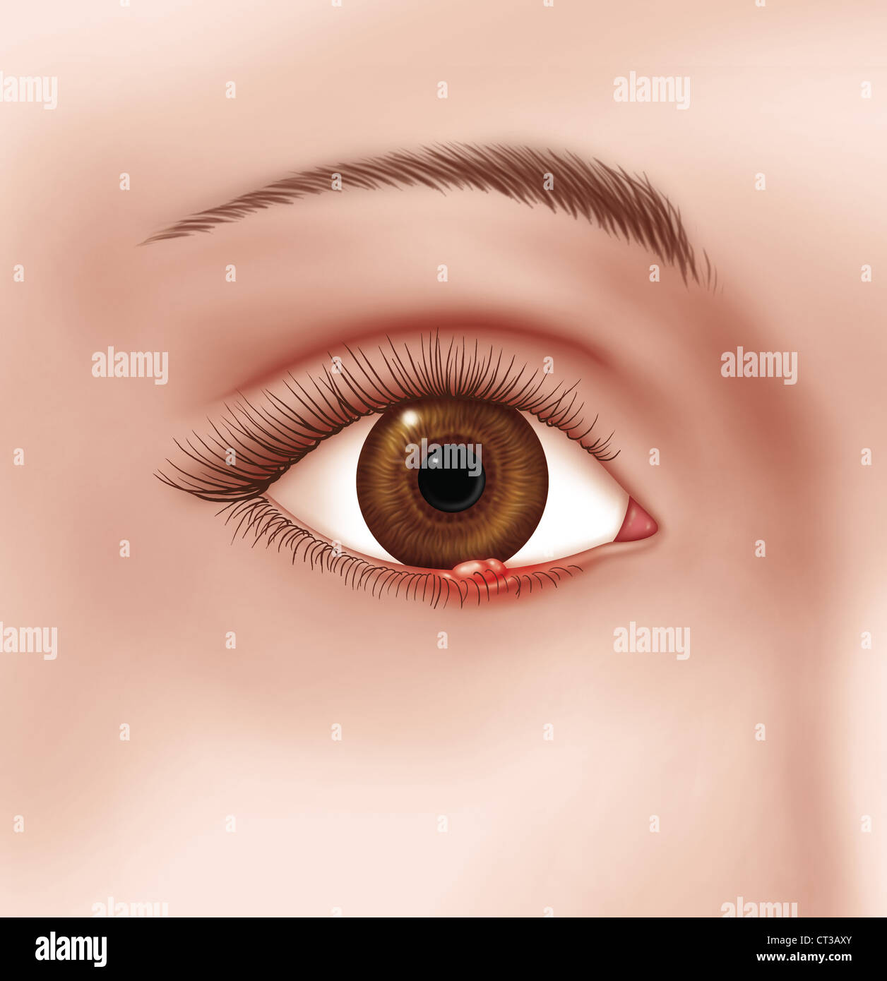 Stye Infection Stockfotos und -bilder Kaufen - Alamy