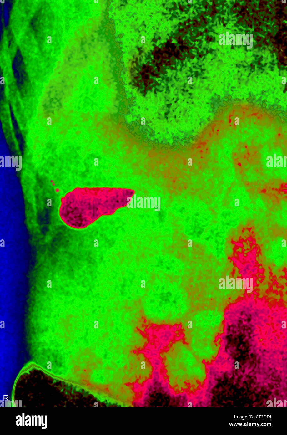 SUBPHRENIC ABSZESS, X-RAY Stockfotografie - Alamy