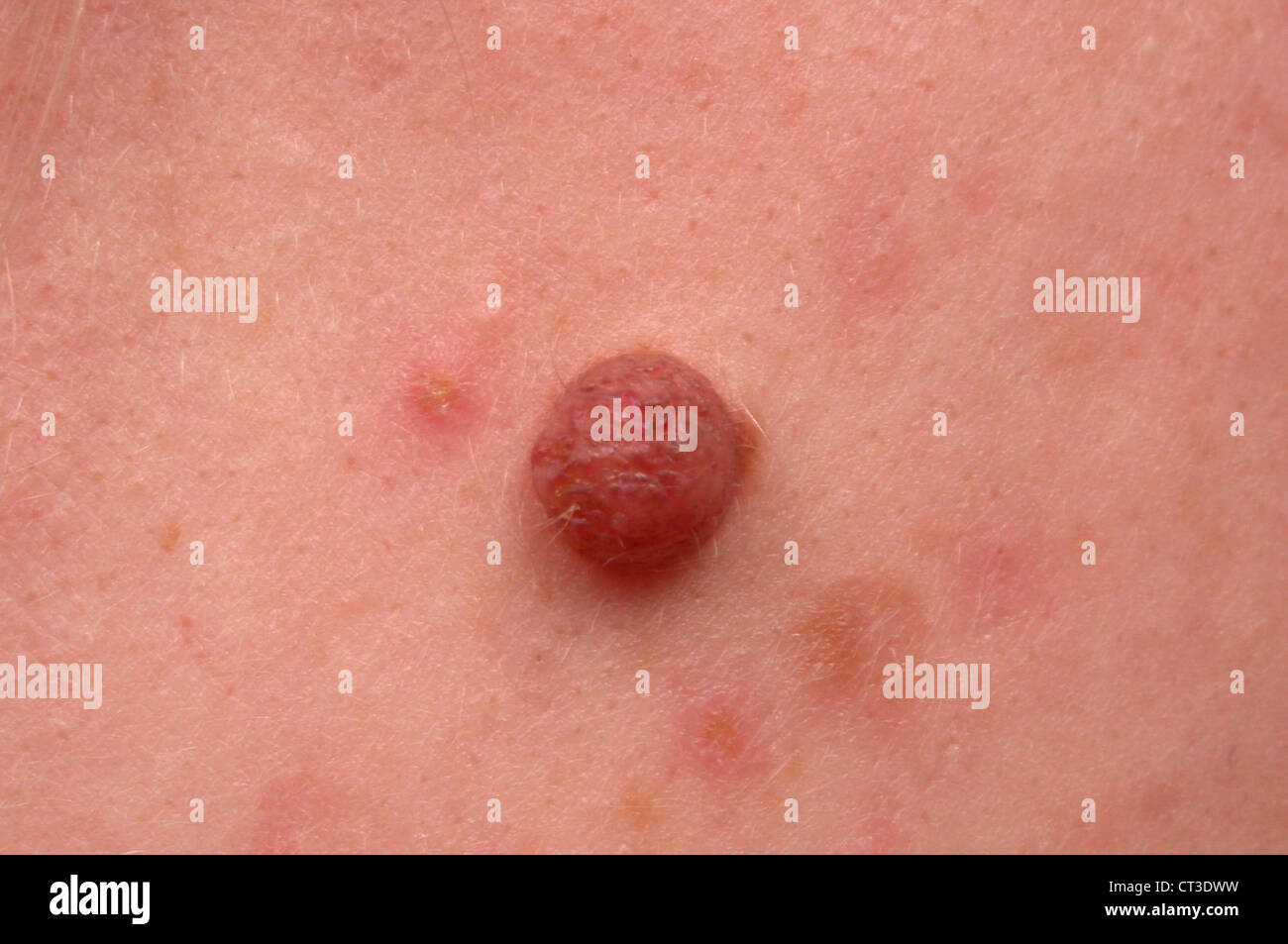 Gutartiger hauttumor gesicht -Fotos und -Bildmaterial in hoher ...