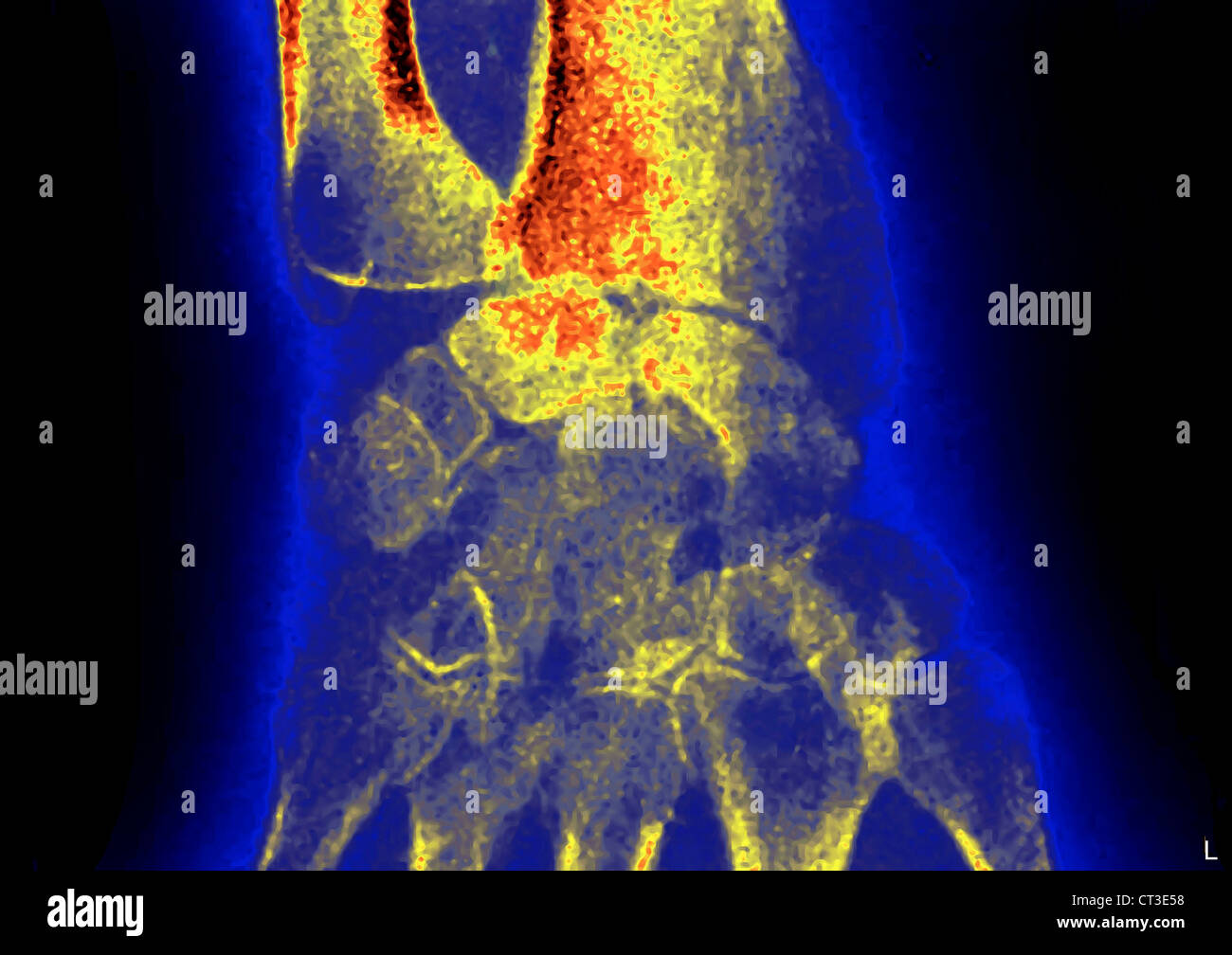 ARTHRITIS HAND, X-RAY Stockfotografie - Alamy