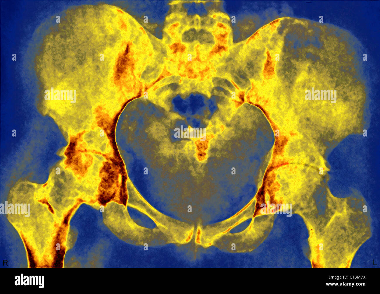 Hüfte Arthrose Röntgenbild Stockfotos und -bilder Kaufen - Alamy
