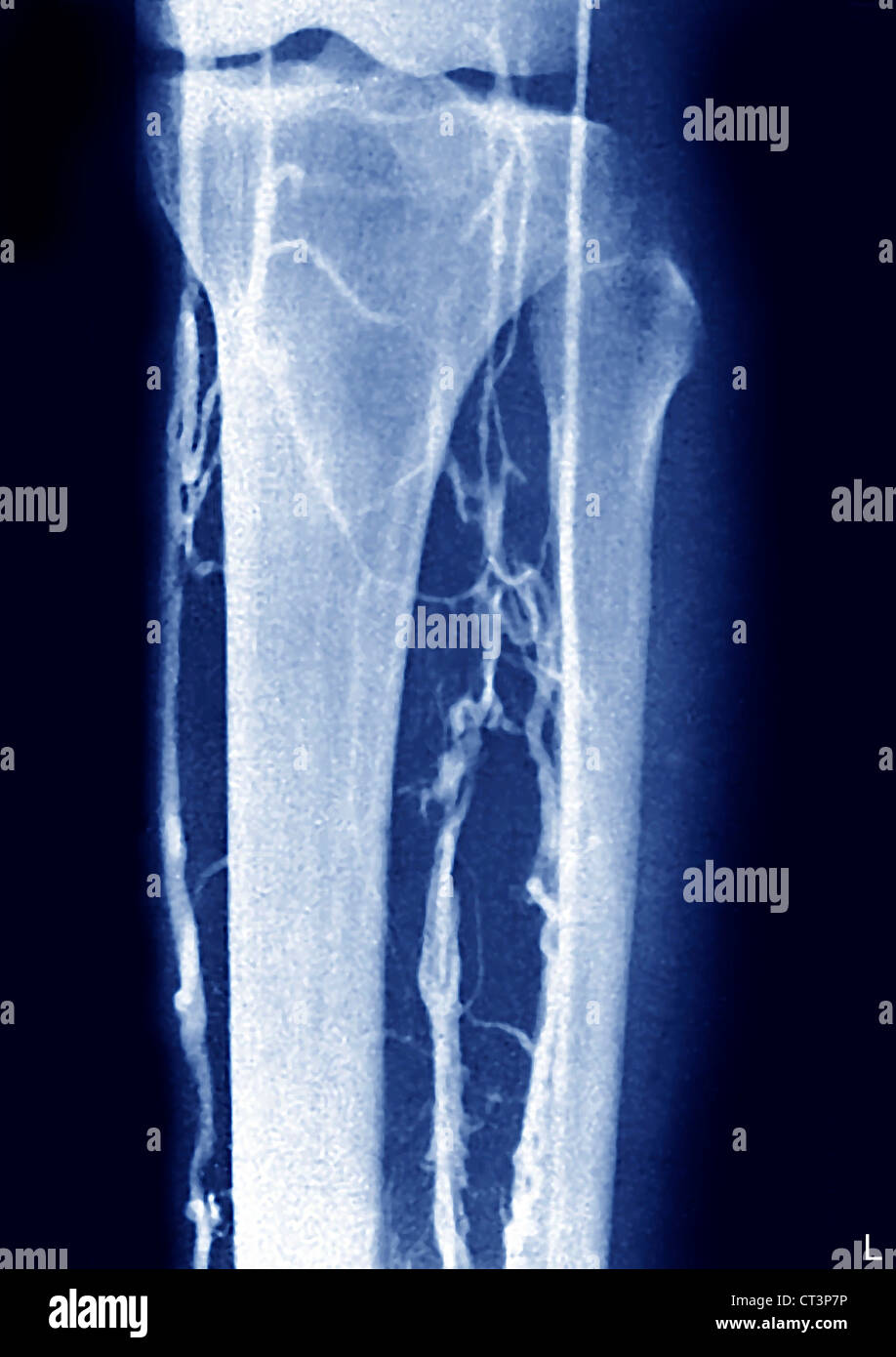Thrombose bein -Fotos und -Bildmaterial in hoher Auflösung – Alamy