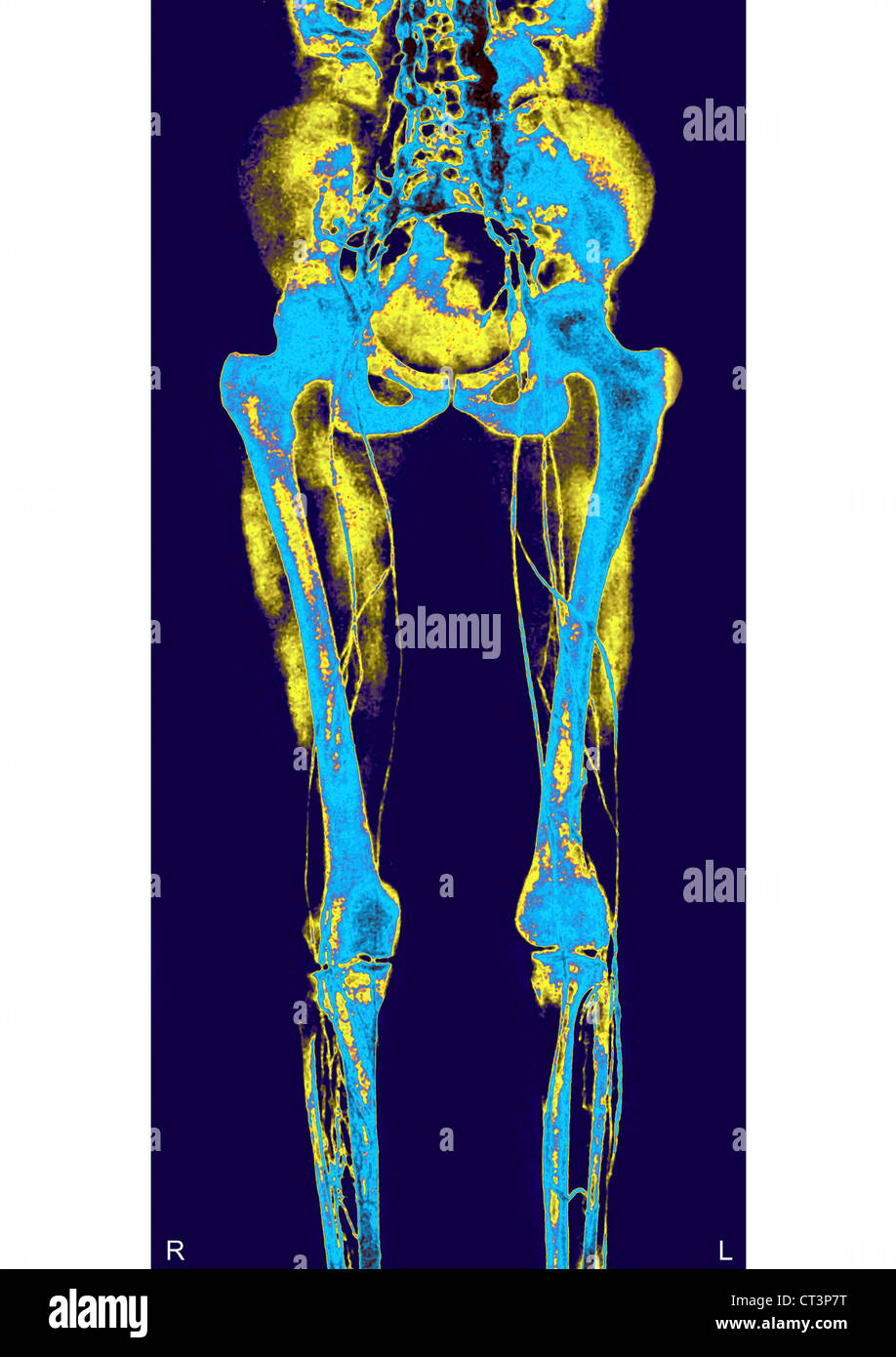 Thrombose bein -Fotos und -Bildmaterial in hoher Auflösung - Seite 2 ...