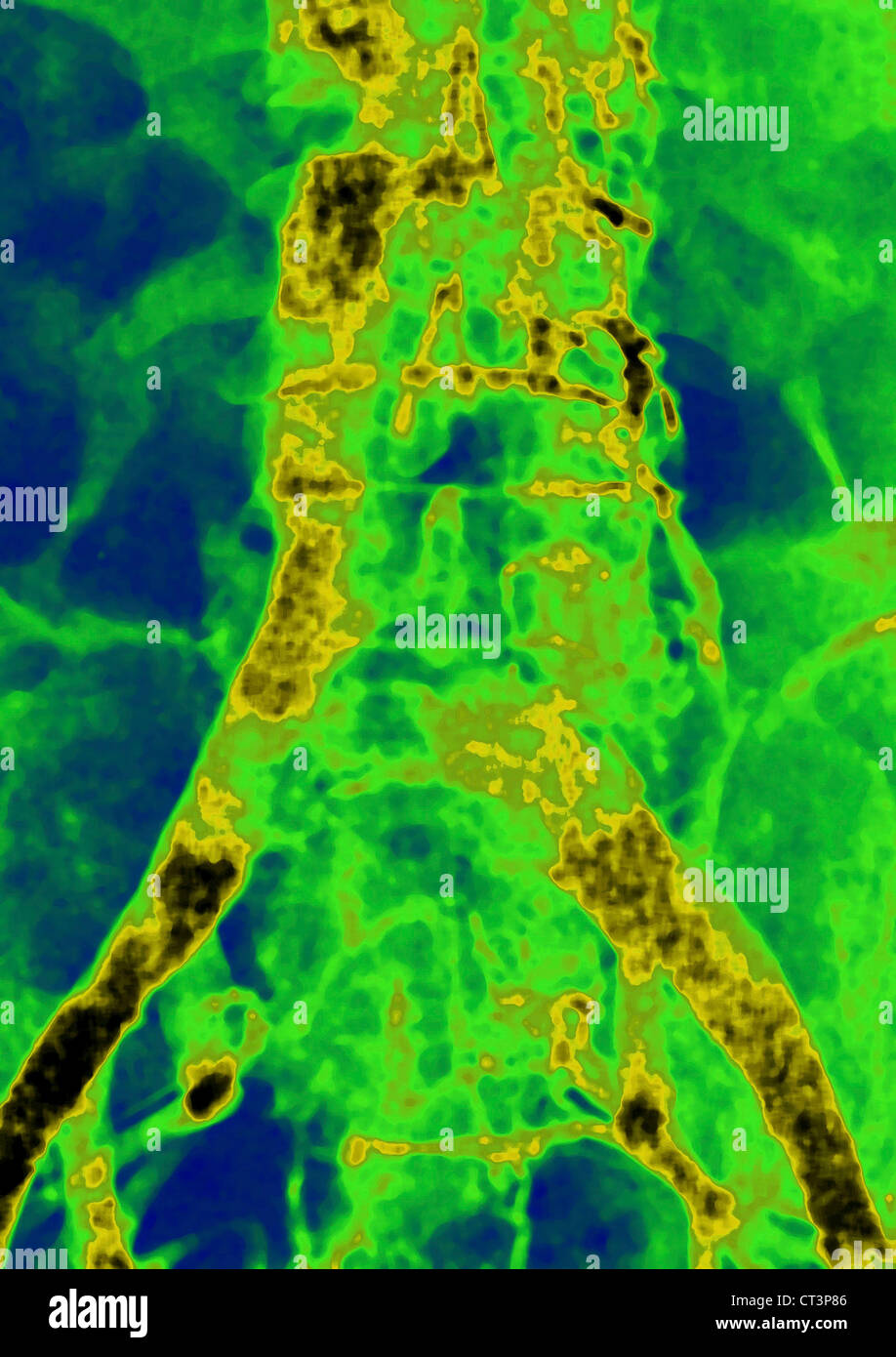 BECKENKAMM THROMBOSE, ANGIOGRAPHIE Stockfotografie - Alamy