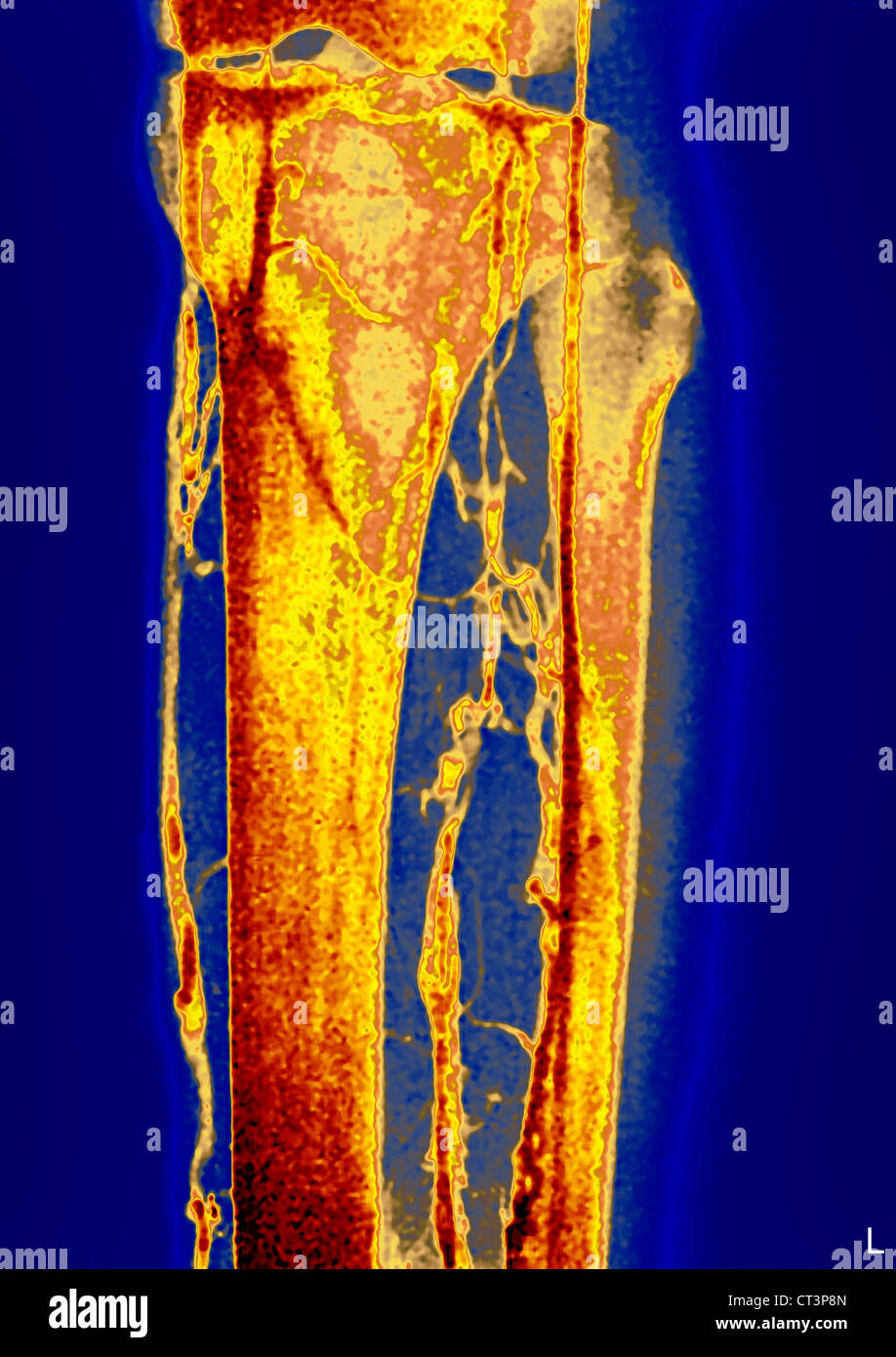 Thrombose bein -Fotos und -Bildmaterial in hoher Auflösung - Seite 2 ...