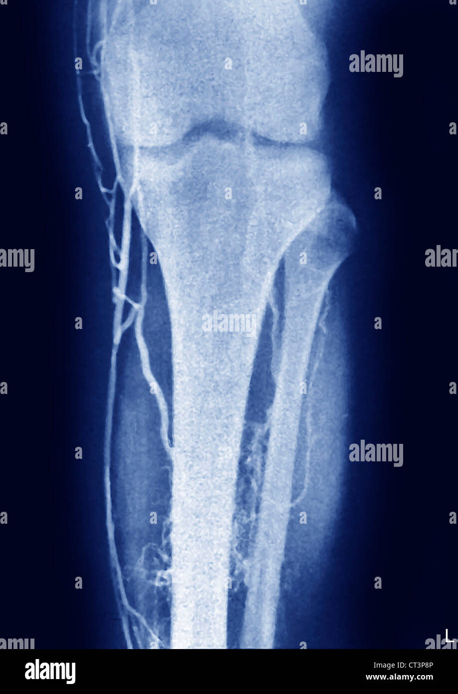 Thrombose bein -Fotos und -Bildmaterial in hoher Auflösung – Alamy