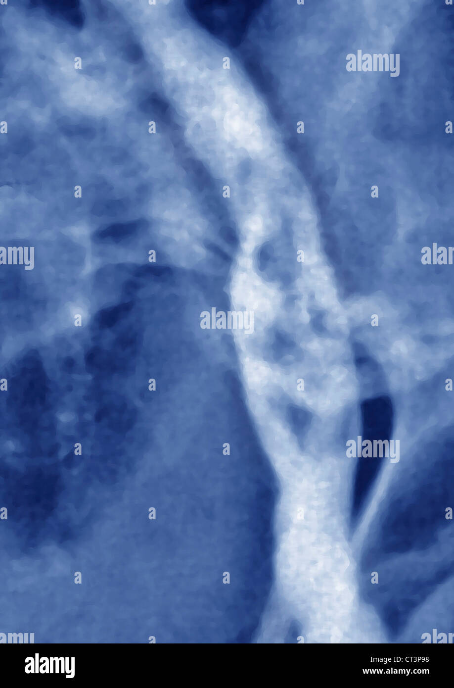 BECKENKAMM THROMBOSE, ANGIOGRAPHIE Stockfotografie - Alamy
