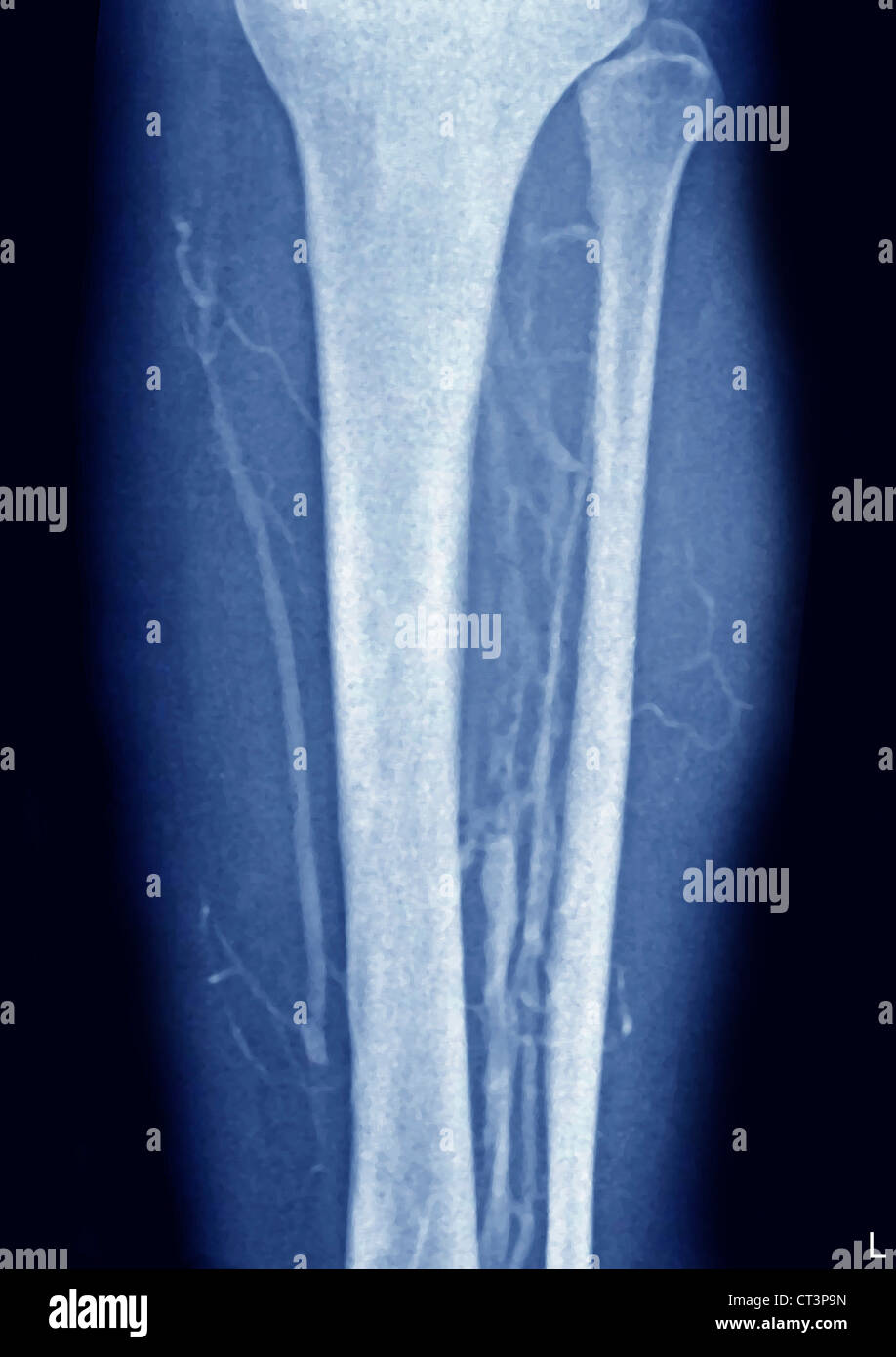 Thrombose bein -Fotos und -Bildmaterial in hoher Auflösung - Seite 2 ...