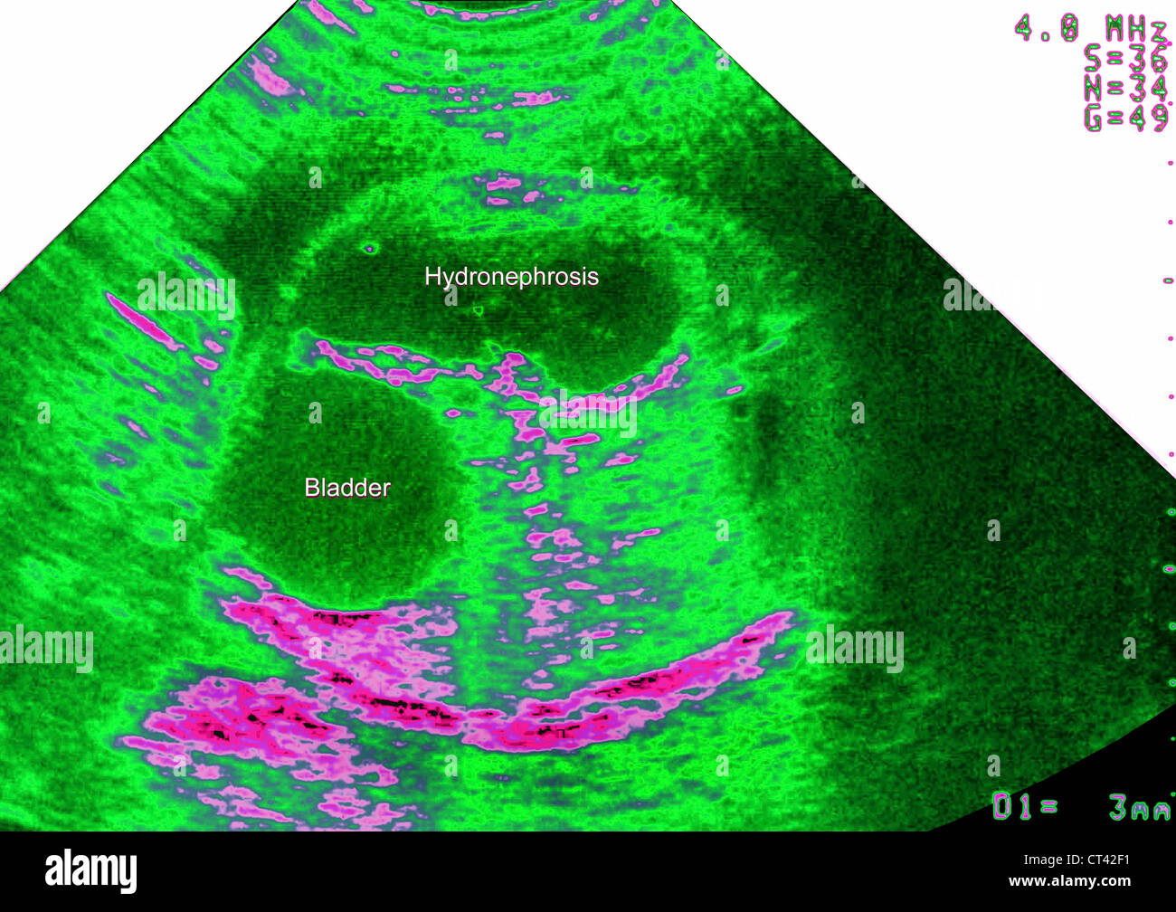 Hydronephrosis of the kidney -Fotos und -Bildmaterial in hoher ...