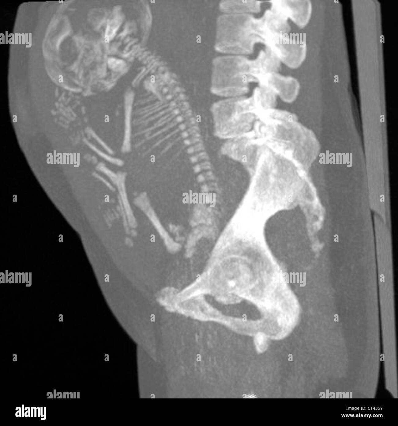 Normal female pelvis -Fotos und -Bildmaterial in hoher Auflösung – Alamy