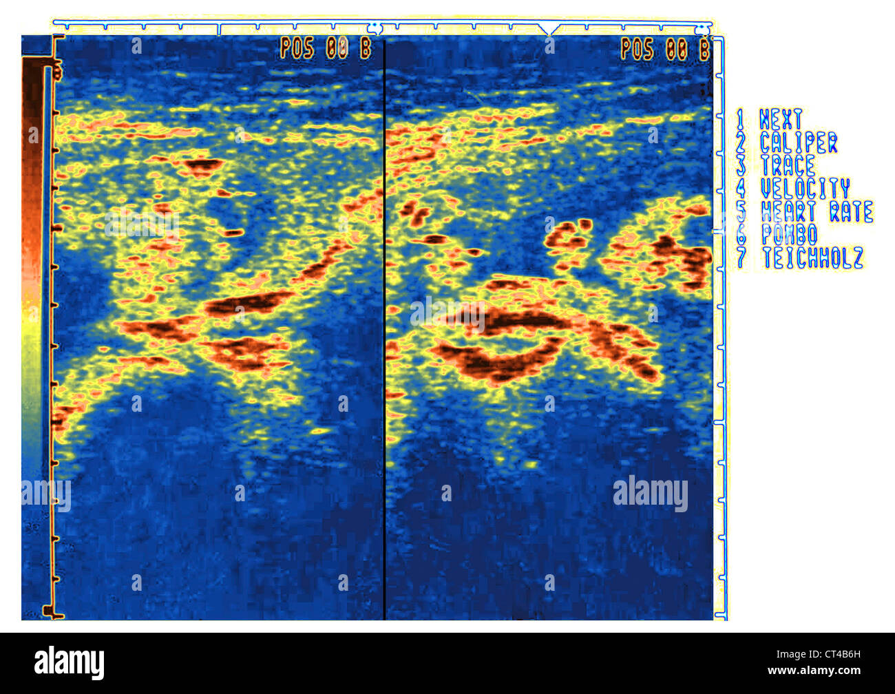 Ventral hernia -Fotos und -Bildmaterial in hoher Auflösung – Alamy