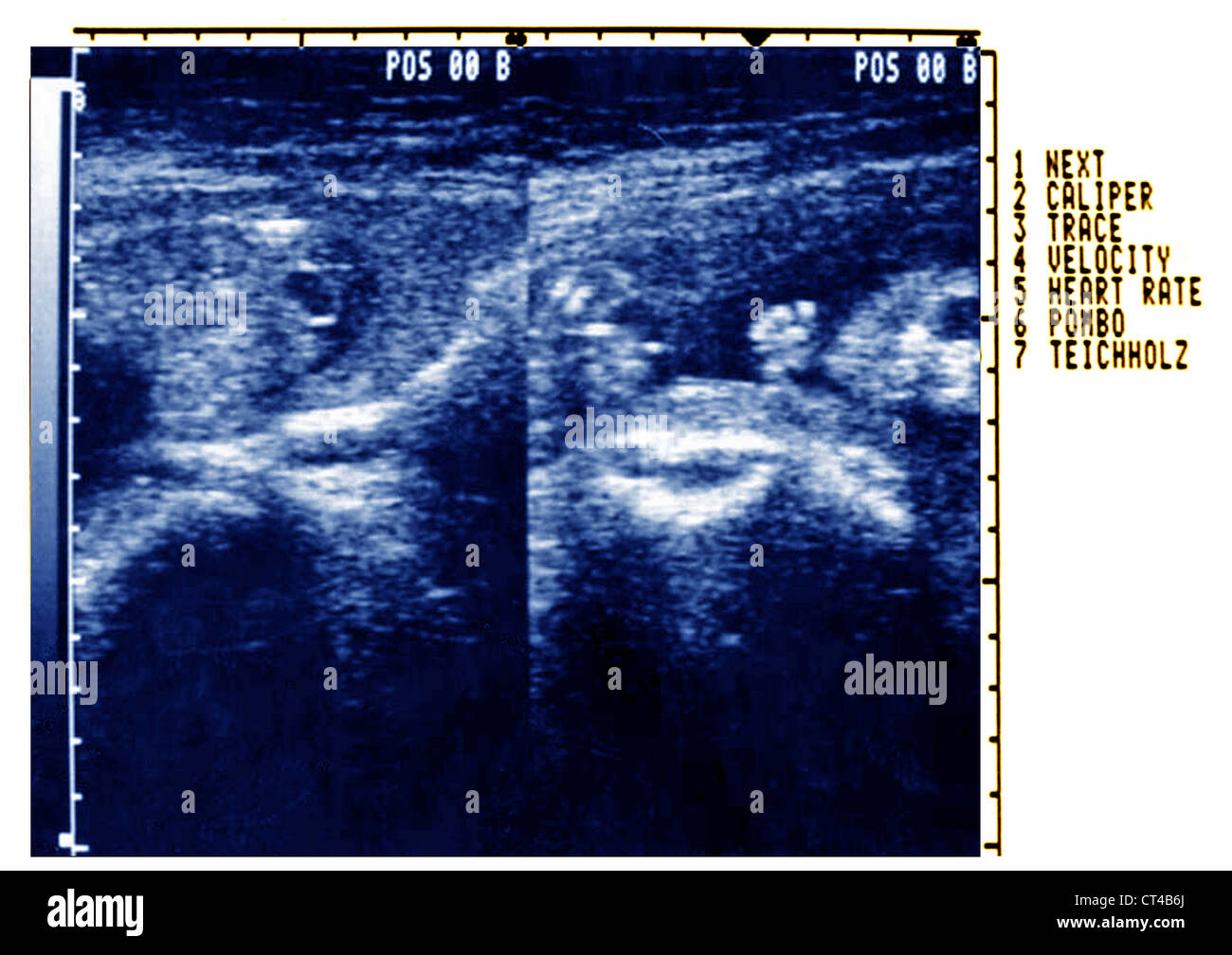 Umbilical hernia -Fotos und -Bildmaterial in hoher Auflösung – Alamy