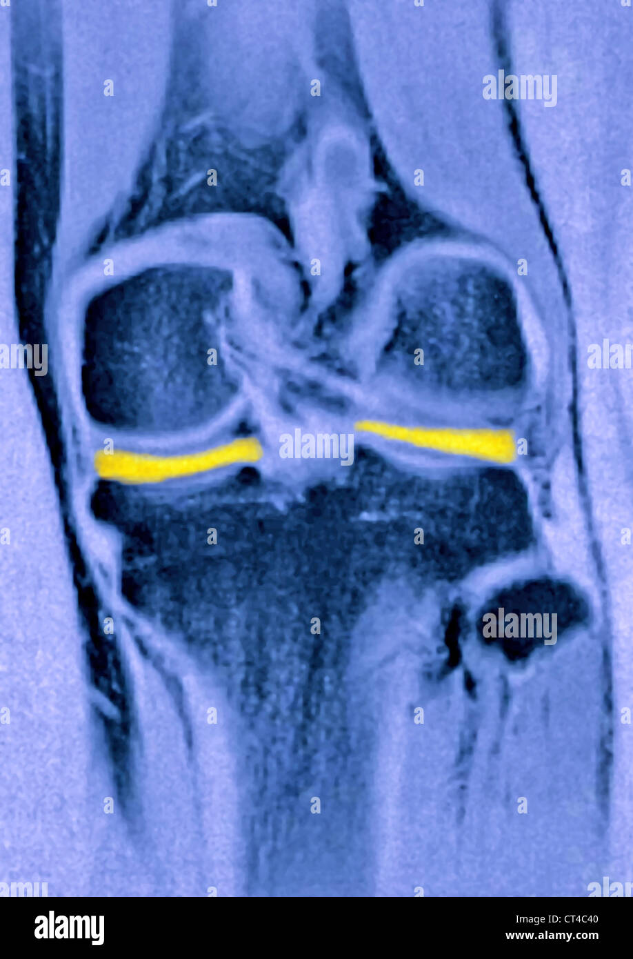 Normal mri knee -Fotos und -Bildmaterial in hoher Auflösung – Alamy