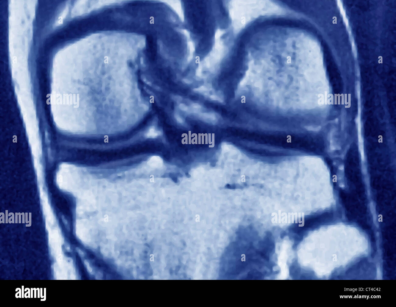 Knee joint mri -Fotos und -Bildmaterial in hoher Auflösung – Alamy