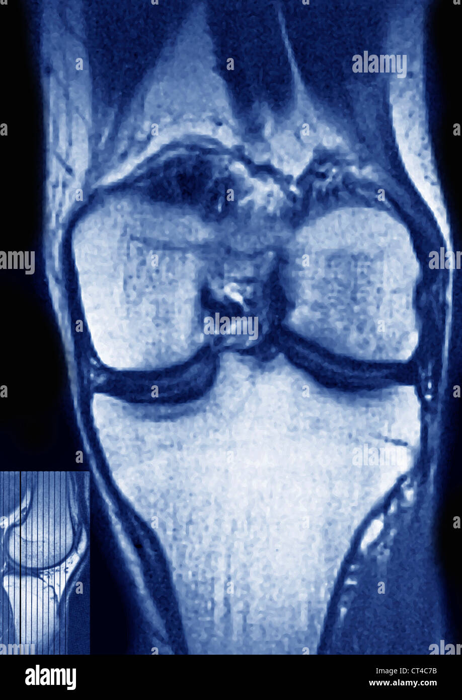 Knee joint mri -Fotos und -Bildmaterial in hoher Auflösung – Alamy