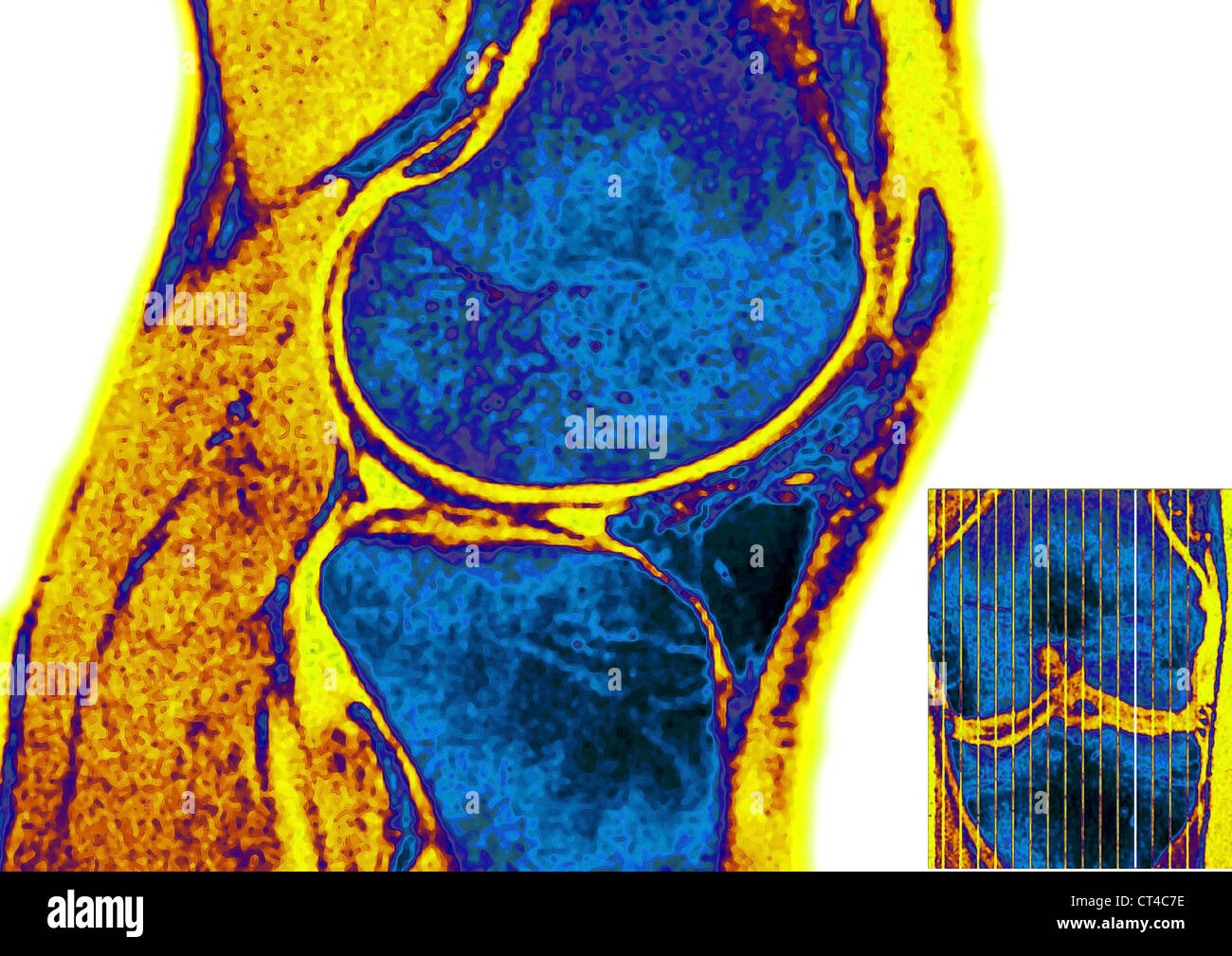 Bones of the knee -Fotos und -Bildmaterial in hoher Auflösung - Seite 3 ...