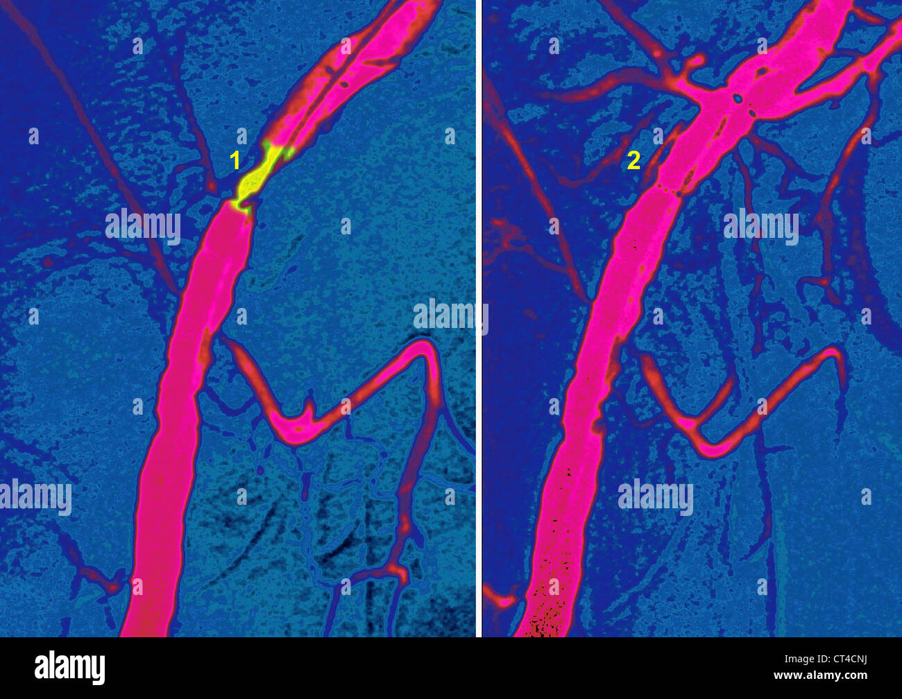 BECKENKAMM STENOSE, ANGIOPLASTIE Stockfotografie - Alamy