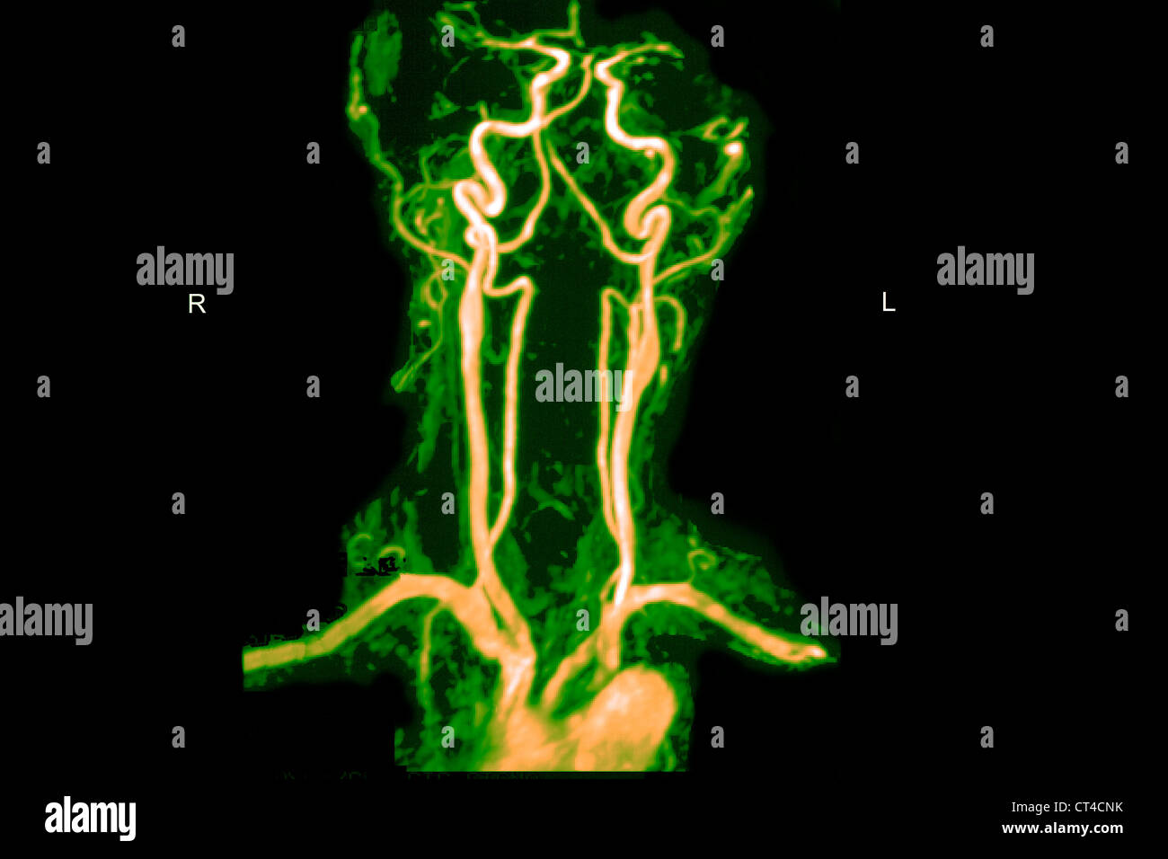 Arteria carotis externa -Fotos und -Bildmaterial in hoher Auflösung – Alamy