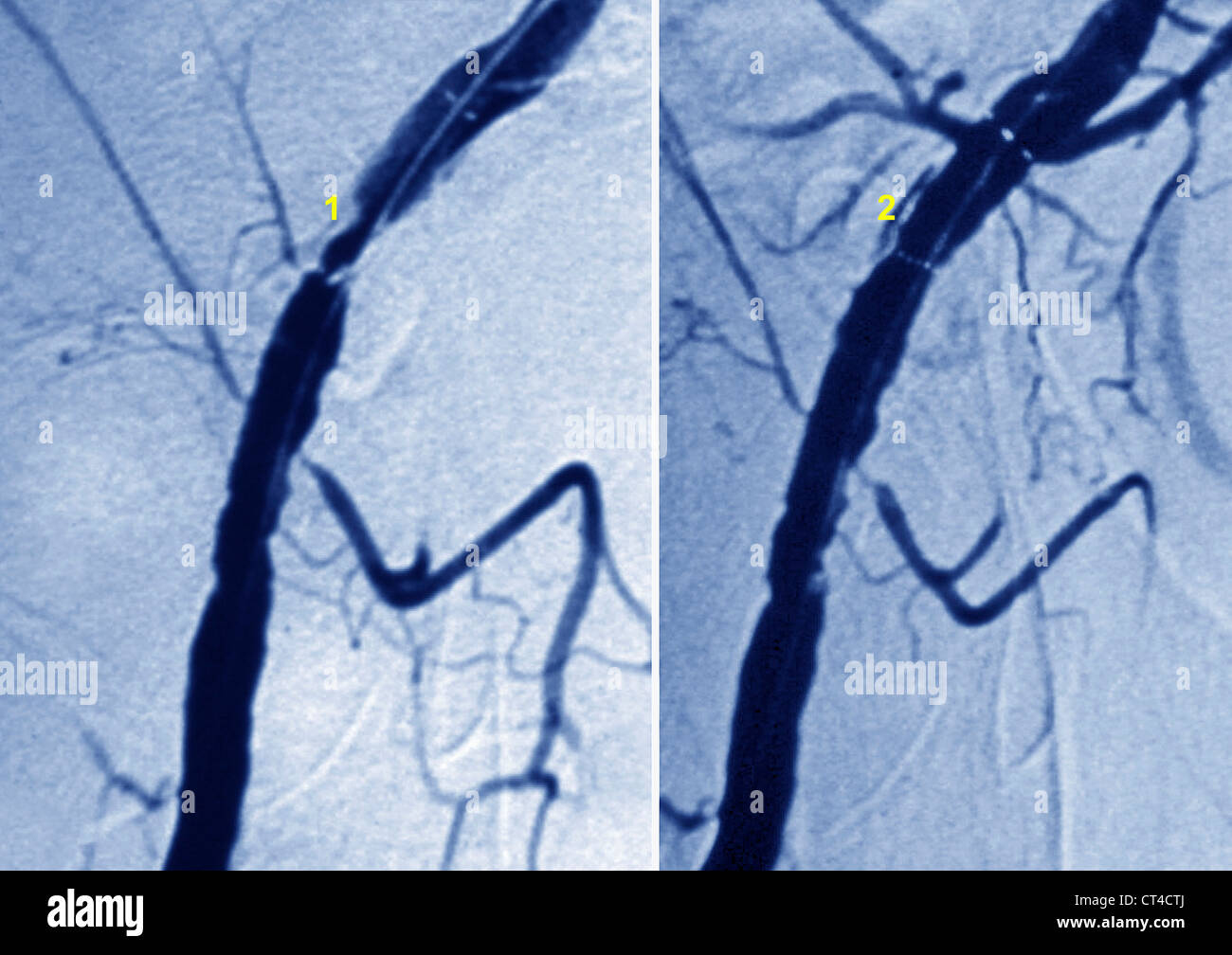 Iliac Stenosis Stockfotos und -bilder Kaufen - Alamy