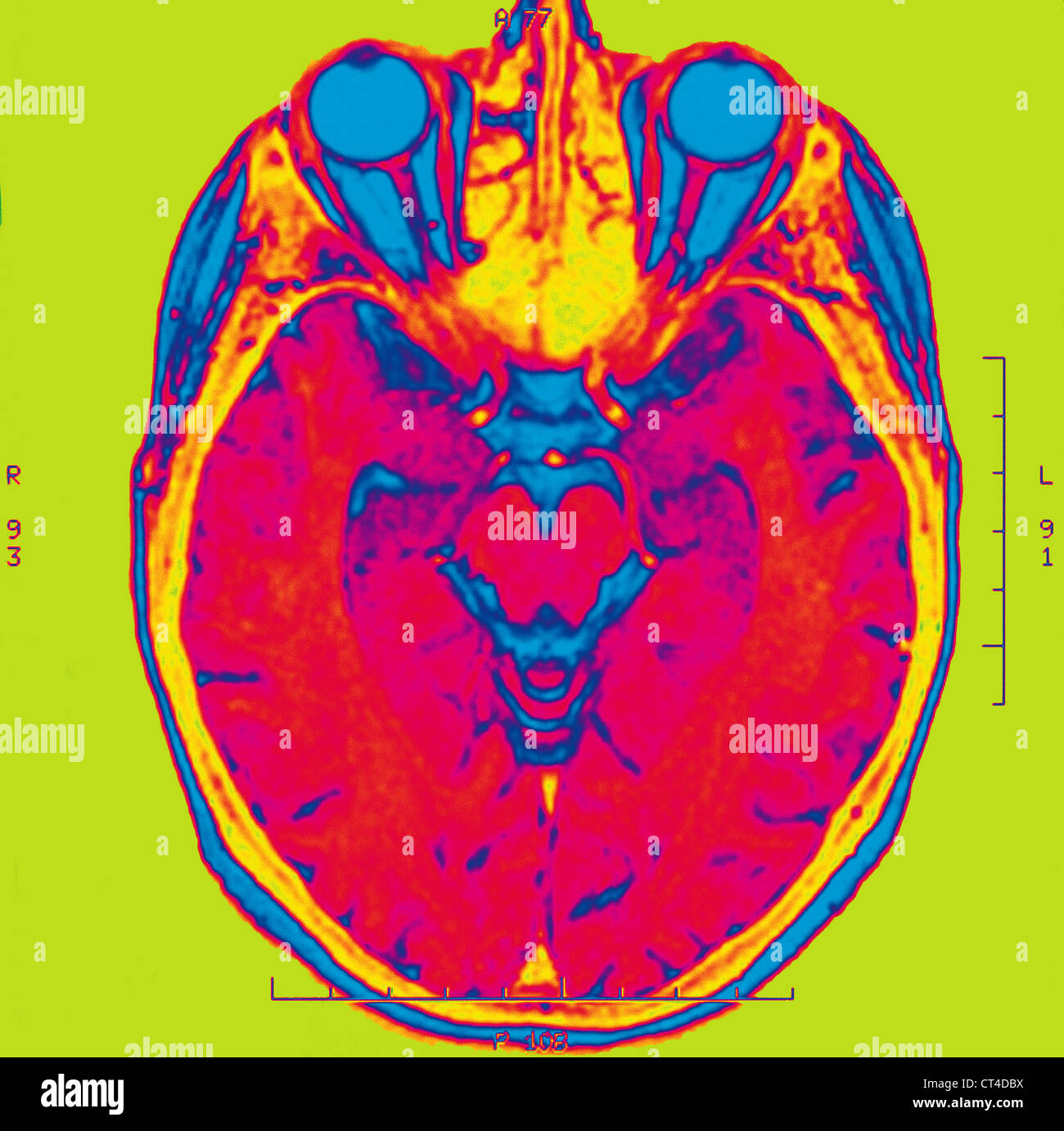 Normal brain mri -Fotos und -Bildmaterial in hoher Auflösung – Alamy