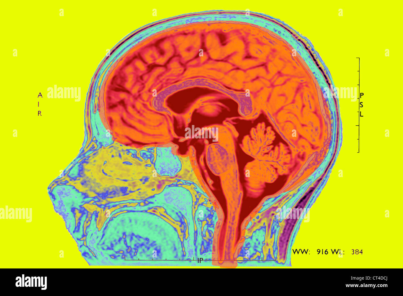 Normal brain mri -Fotos und -Bildmaterial in hoher Auflösung – Alamy