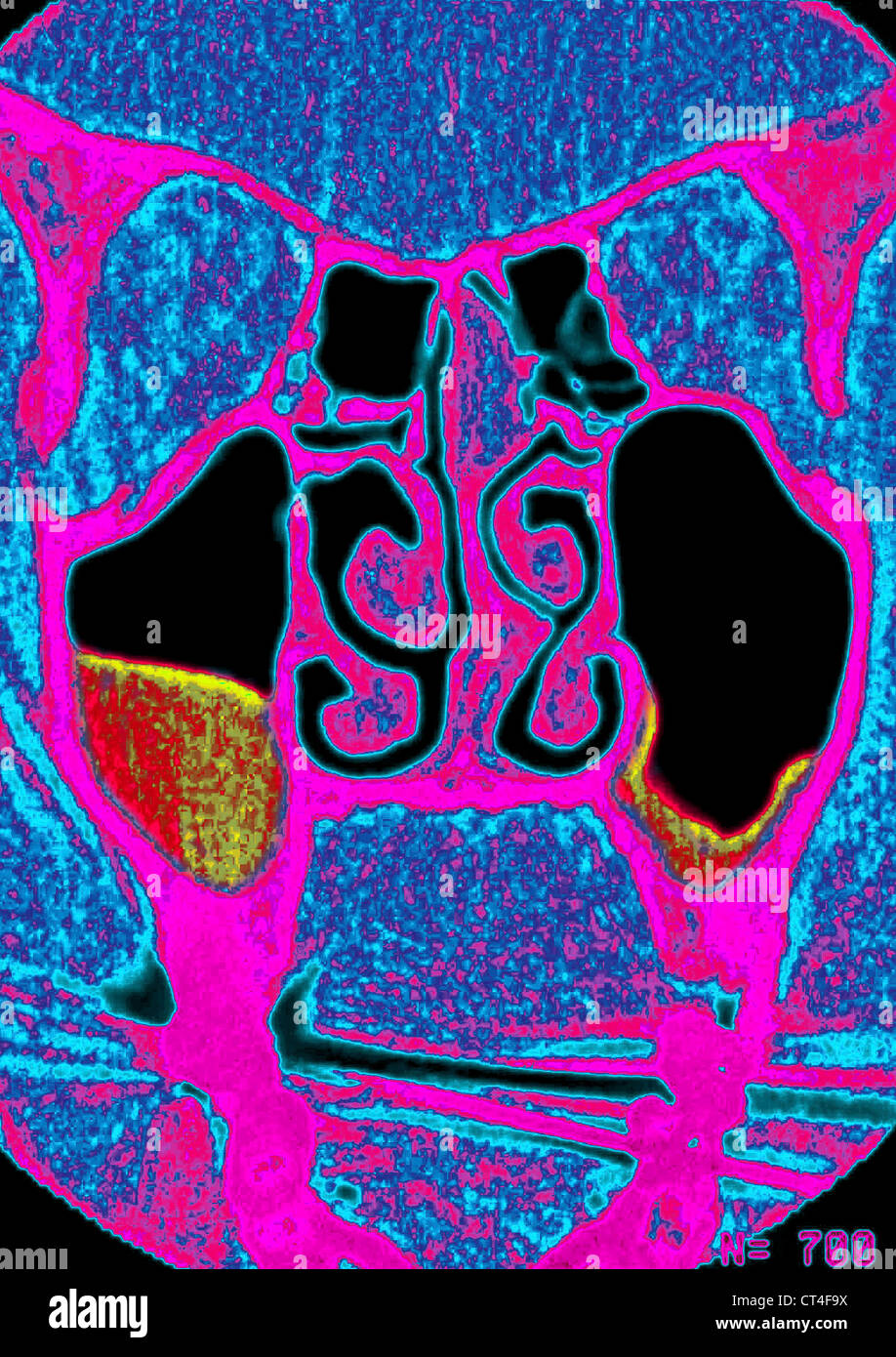 Maxillary Sinuses Stockfotos & Maxillary Sinuses Bilder - Alamy
