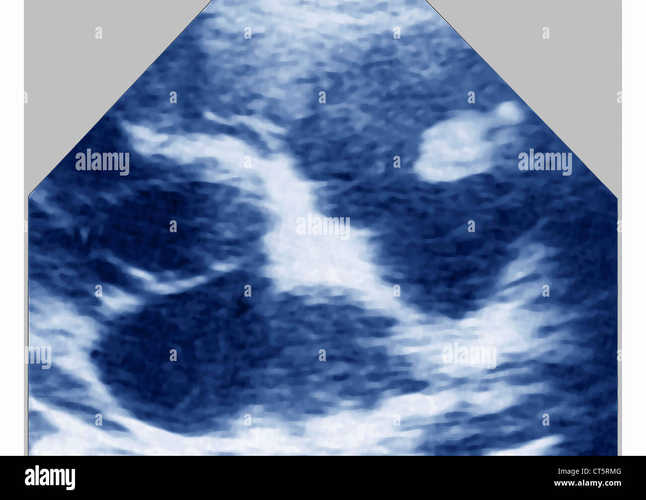 INFEKTIÖSE ENDOKARDITIS, SONOGR Stockfotografie - Alamy