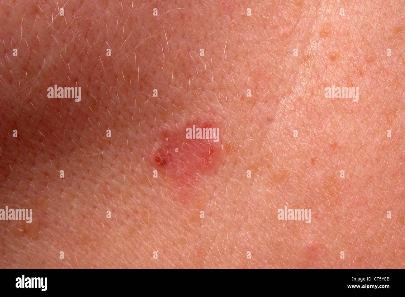 Anaplastisches karzinom -Fotos und -Bildmaterial in hoher Auflösung – Alamy