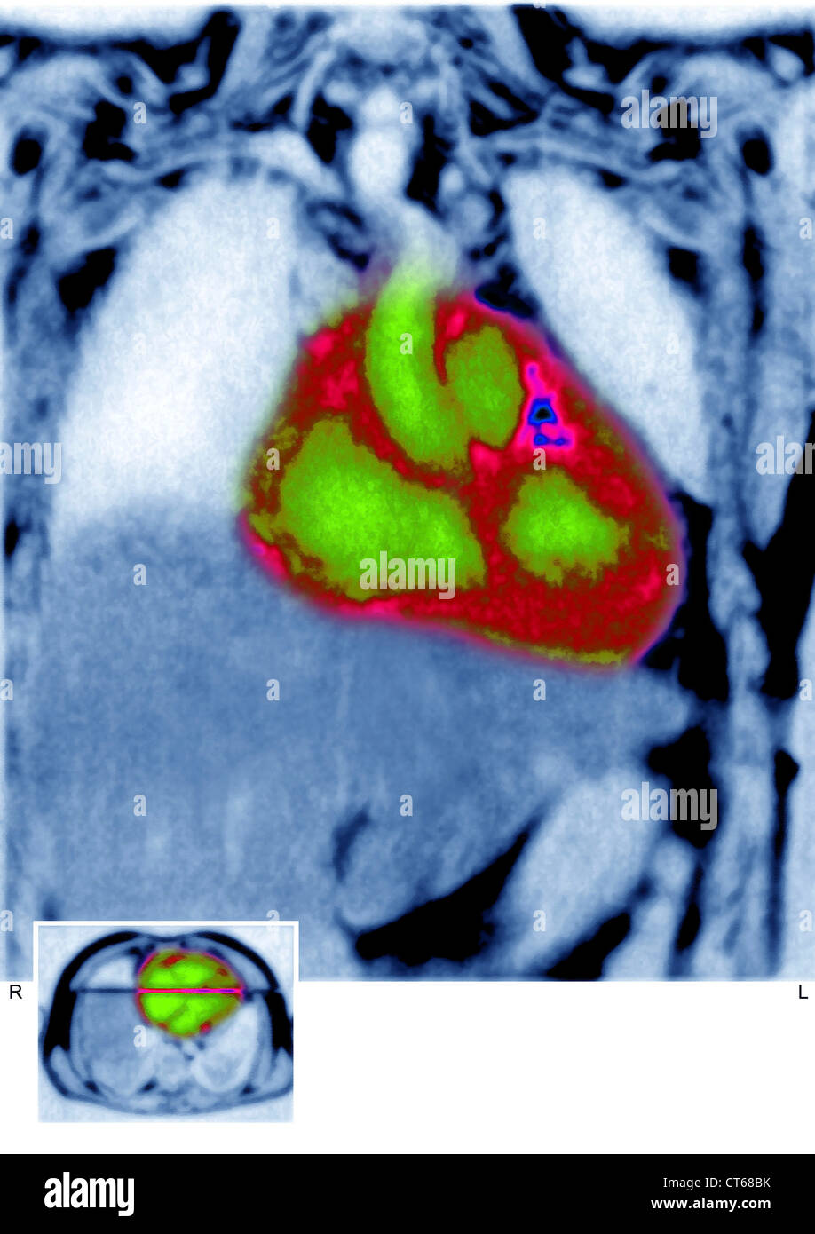 Herz mri -Fotos und -Bildmaterial in hoher Auflösung – Alamy
