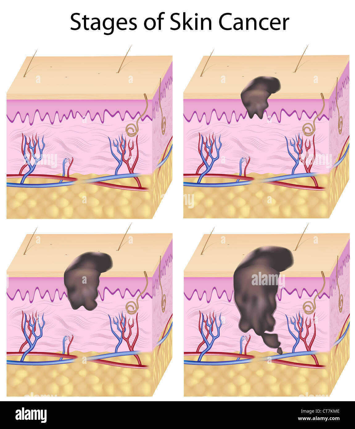 Hautkrebs melanom bösartig -Fotos und -Bildmaterial in hoher Auflösung ...
