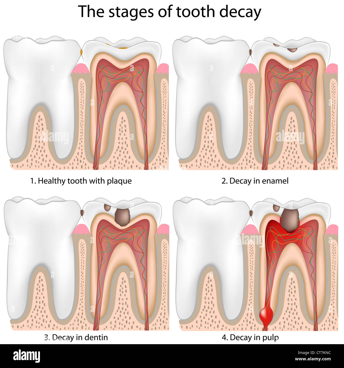 Stadien der karies -Fotos und -Bildmaterial in hoher Auflösung – Alamy
