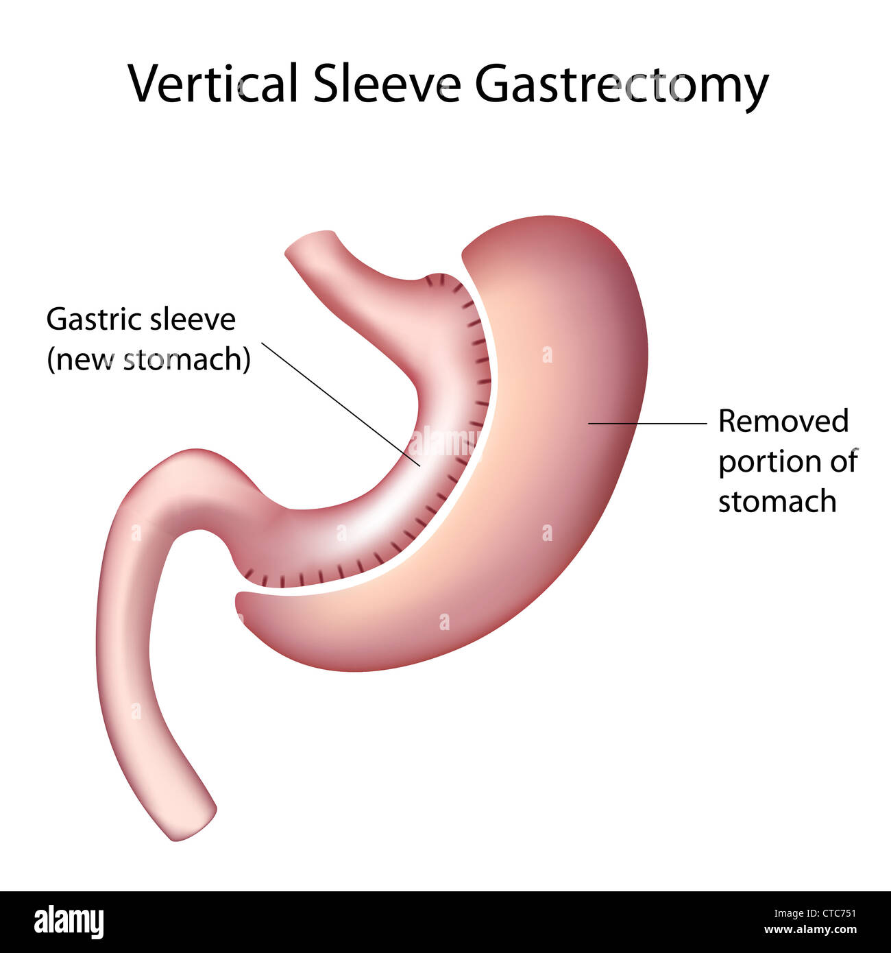Vertikale Sleeve-Gastrektomie (VSG Stockfotografie - Alamy